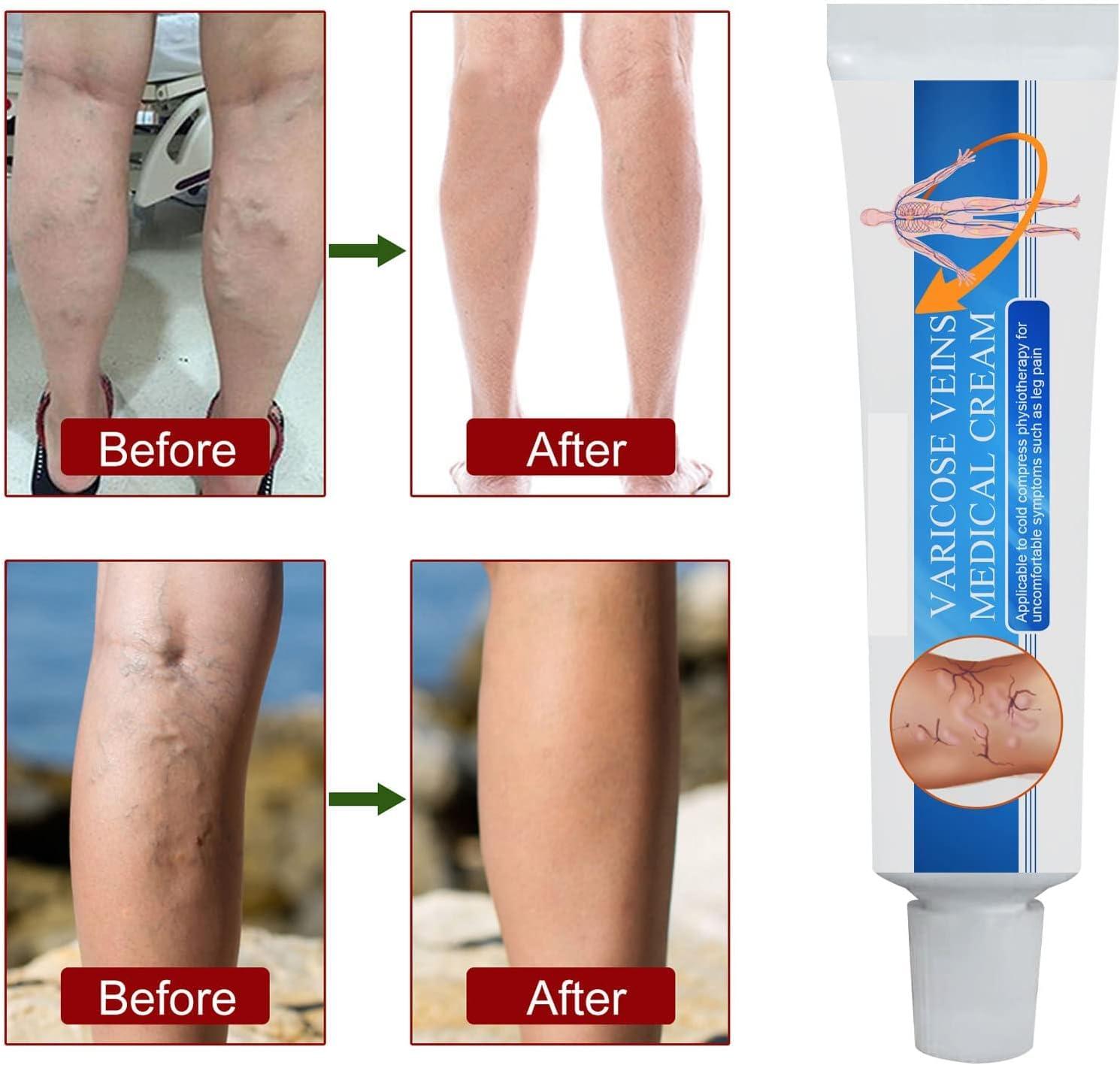 4-Piece Venous Healing Spray for Varicose Veins | Improve Blood Flow ...