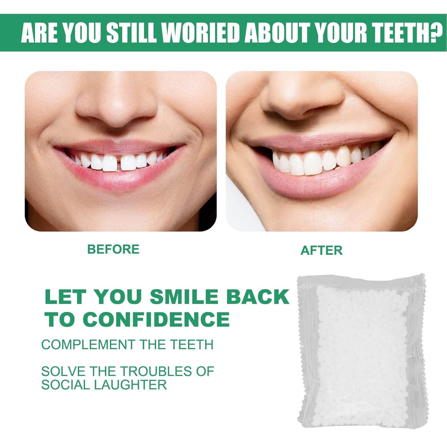 Temporary Tooth Repair Set - Degradable 25g Tooth Filling & Replacement ...