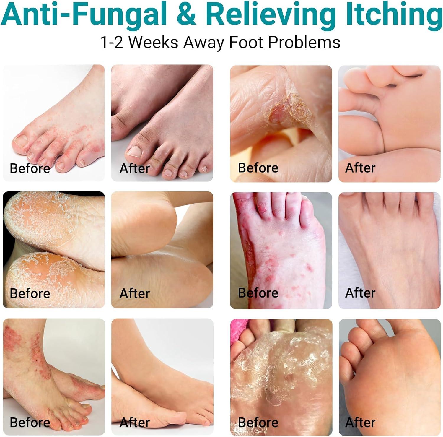 LMNOOP Maximum Strength Athlete's Foot Treatment Cream - Natural Herbal ...