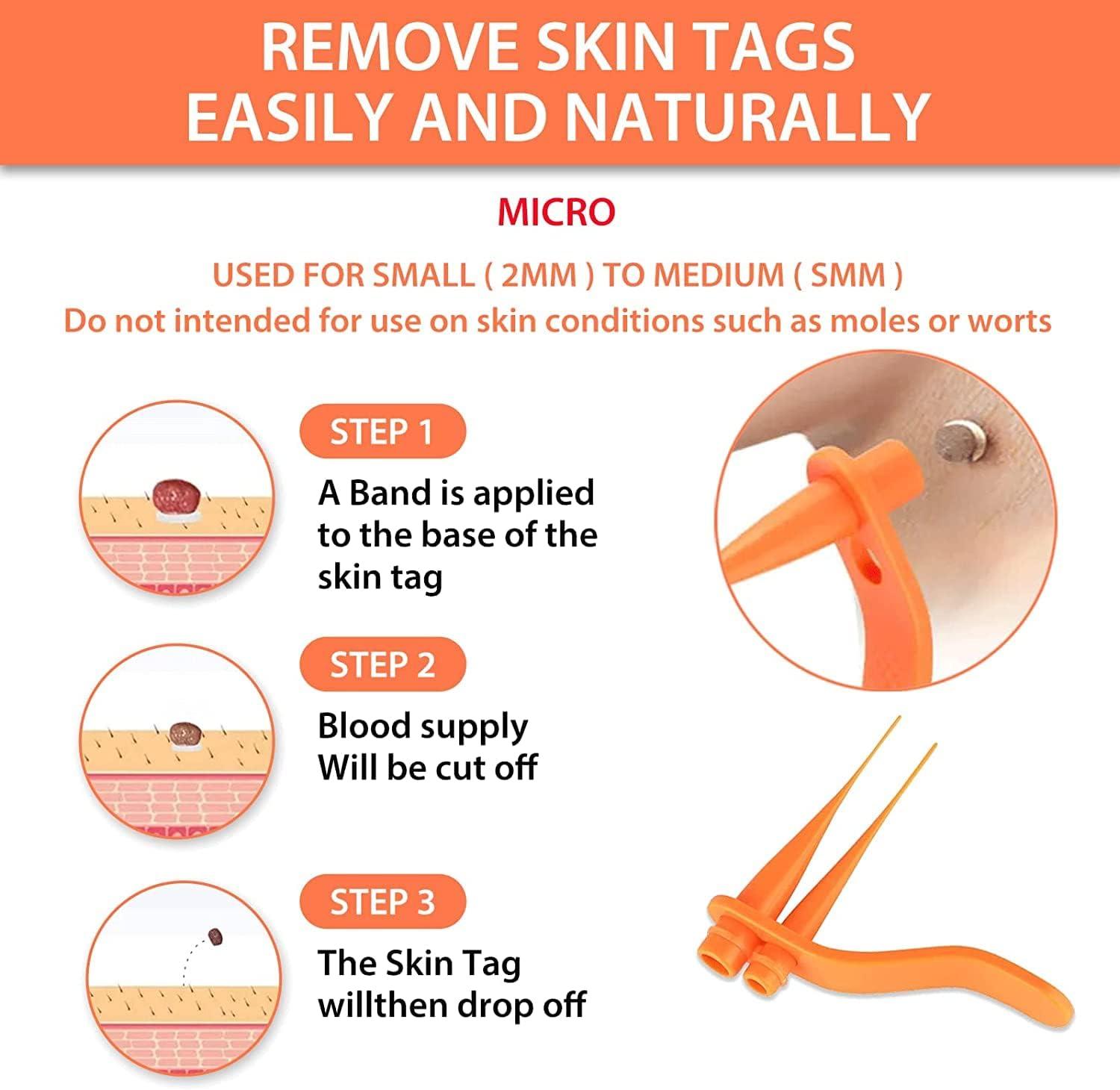 Mole & Skin Tag Removal Kit - Professional 2-in-1 Painless & Safe Wart ...