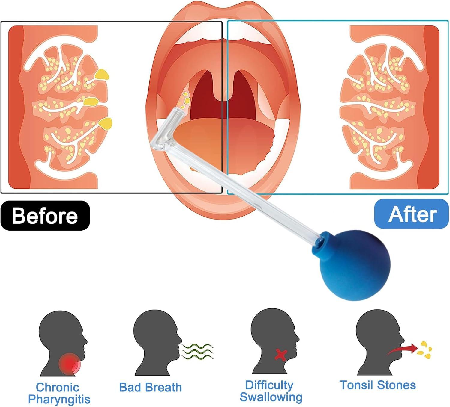Tonsil Stone Remover Tool - Fresh Breath Almond Stones Cleaner with ...