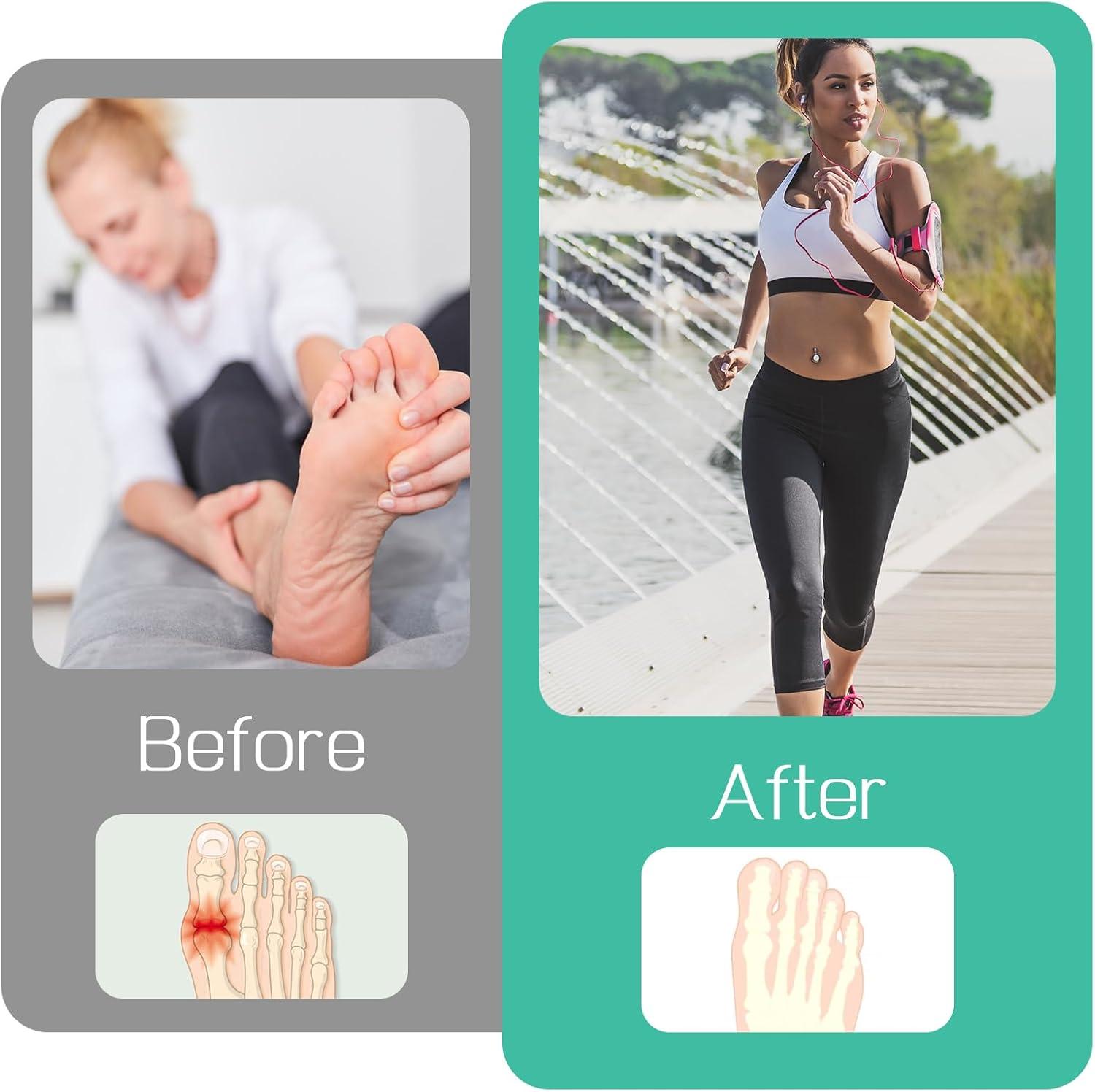 Silicone Toe Covers - 6 Pack White Open Toe Protectors for Small Toes ...