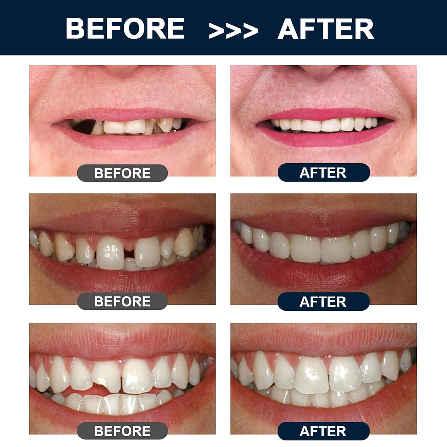 Temporary Tooth Repair Temporary Tooth Replacement Kit Temporary ...