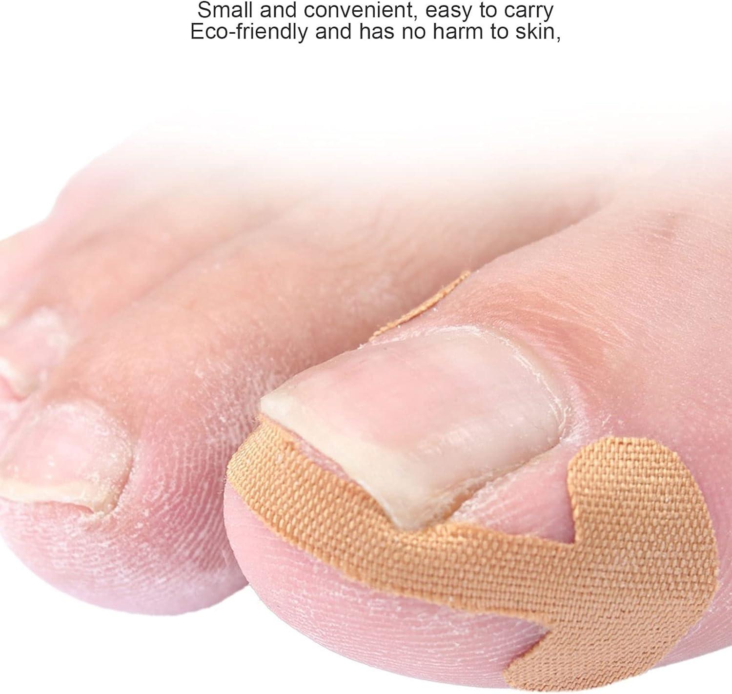 Ingrown Toenail Correction Sticker Adhesive Paronychia Straightening ...