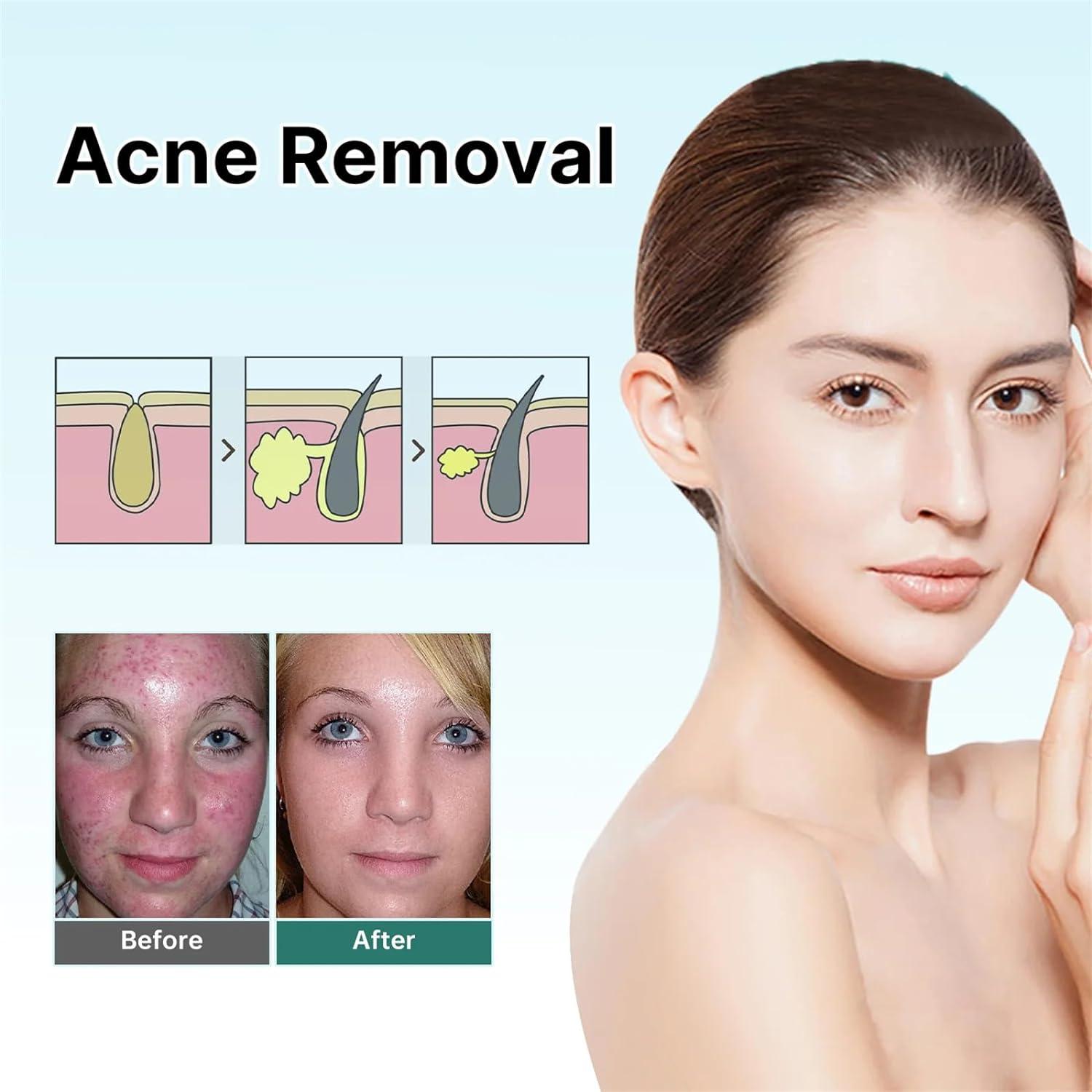 CRusio Awzlove Ampoule Scar Removal Serum - Remove New Scars in 3 Weeks ...