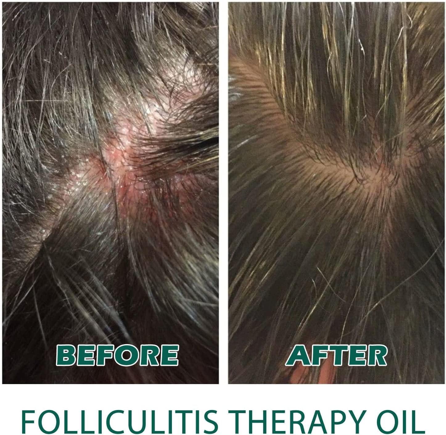GFOUK Scalp Folliculitis Therapy Oil Folliculitis Scalp Oil Nourishing ...