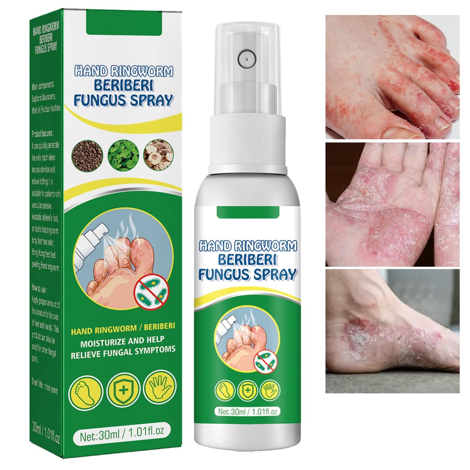Natural Anti-Fungal Foot Spray for Athlete's Foot Treatment - Relieves ...