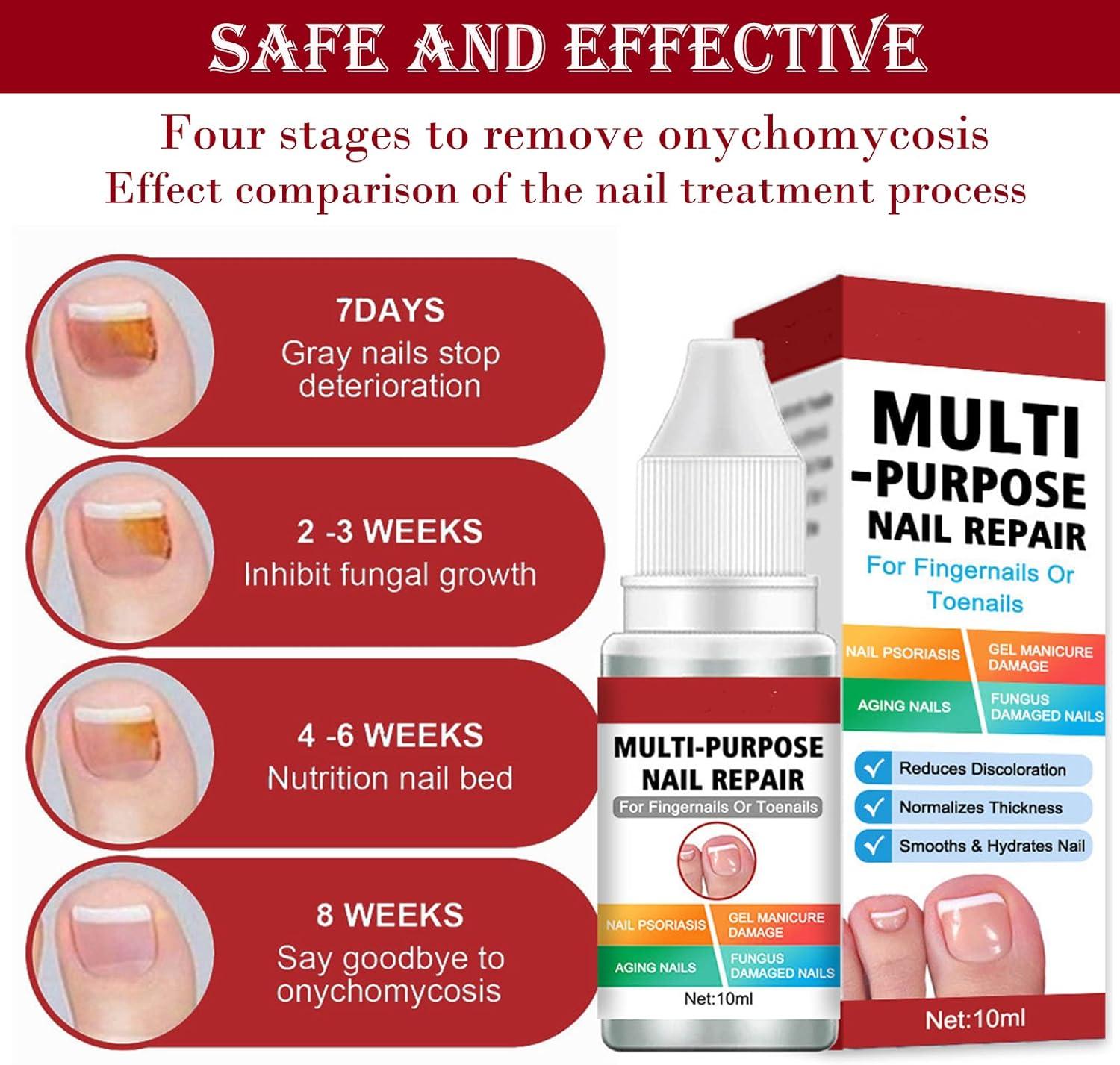 Fungal Nail Treatment Solution - Extra Strong Repair for Toenails ...