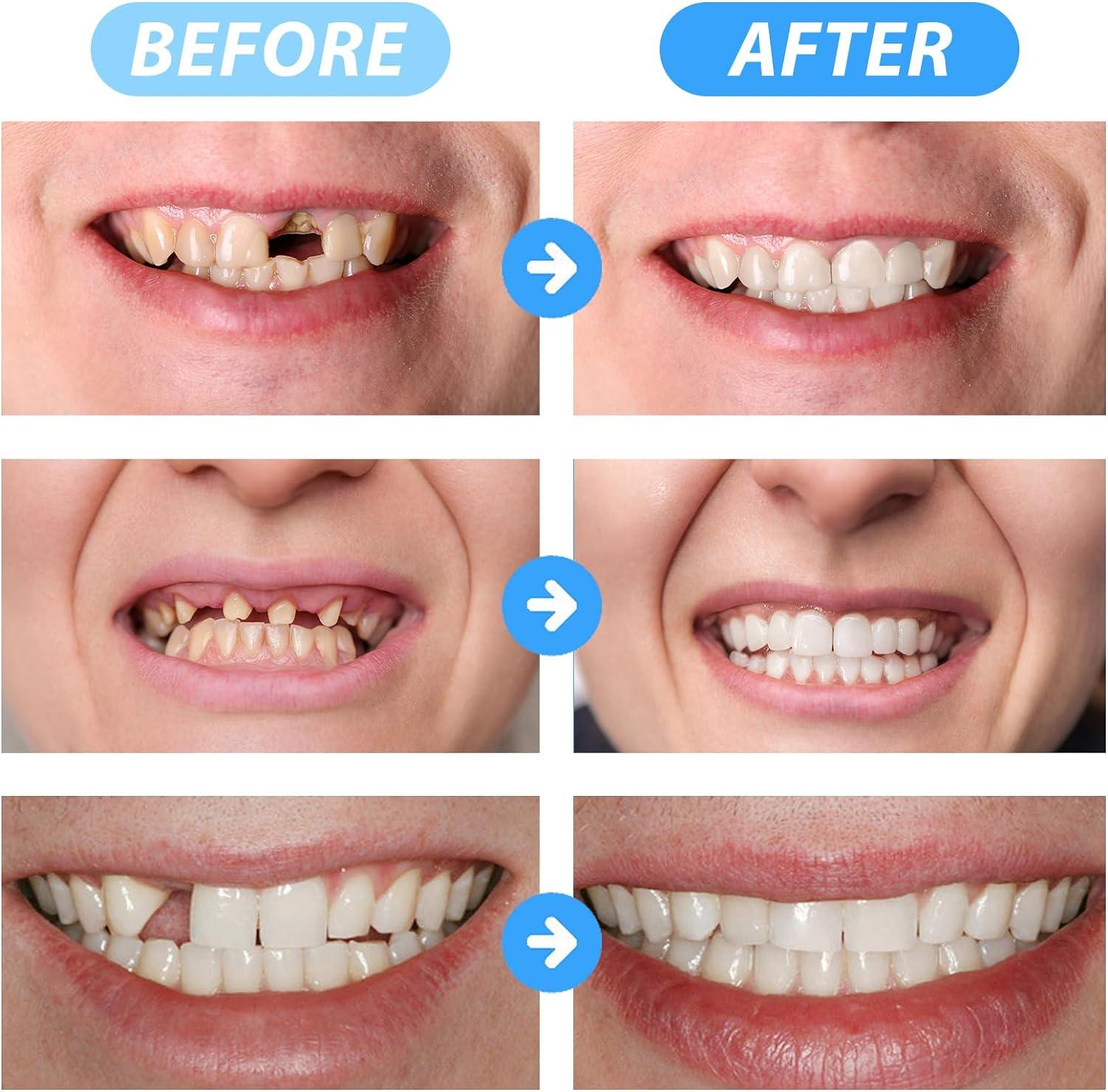 Temporary Tooth Filling Repair Kit with 4 Dental Tools - Safe & Re ...