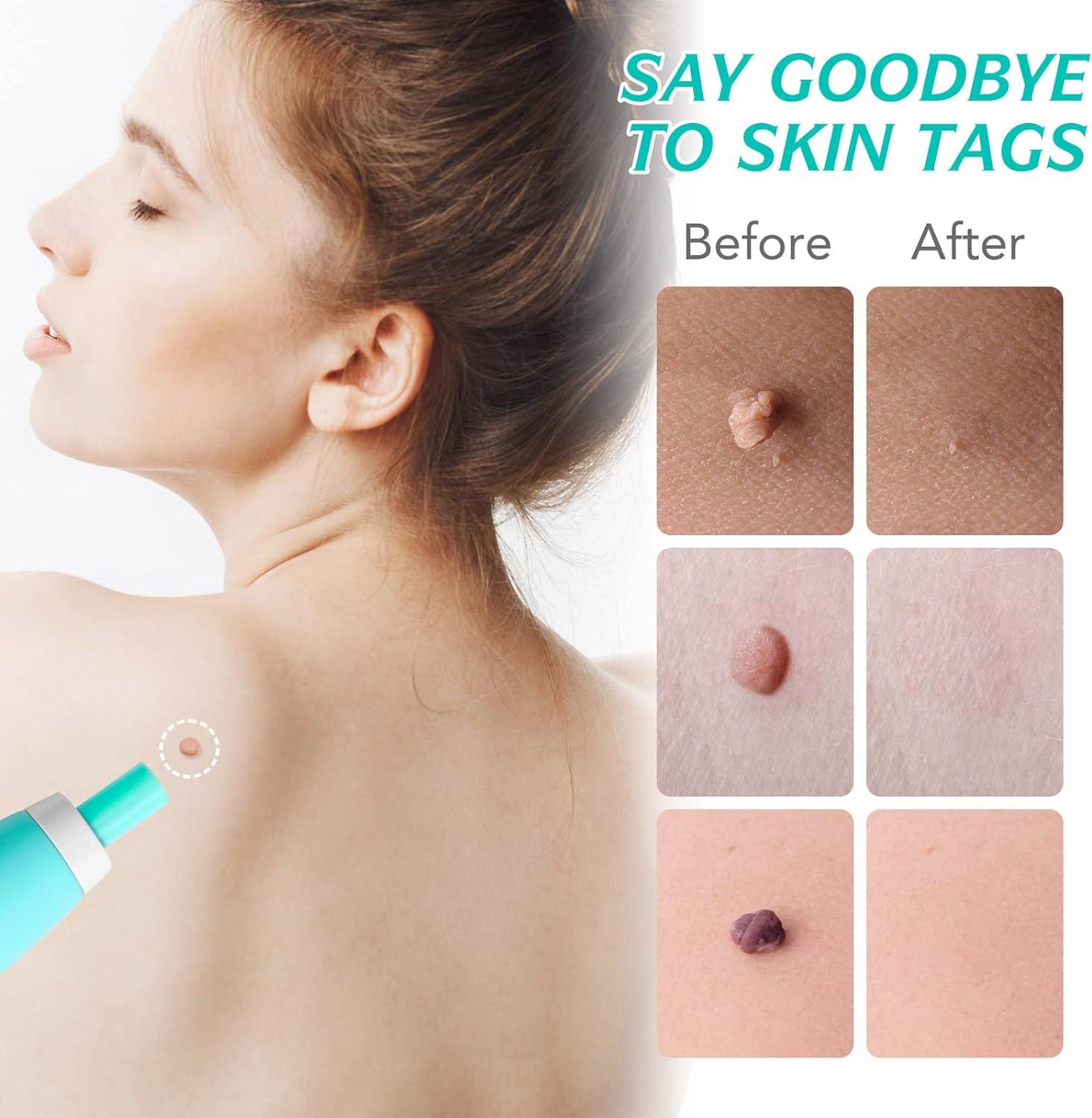 2 in 1 Skin Tag Remover Pen Kit - Painless Micro Skin Tags & Moles ...