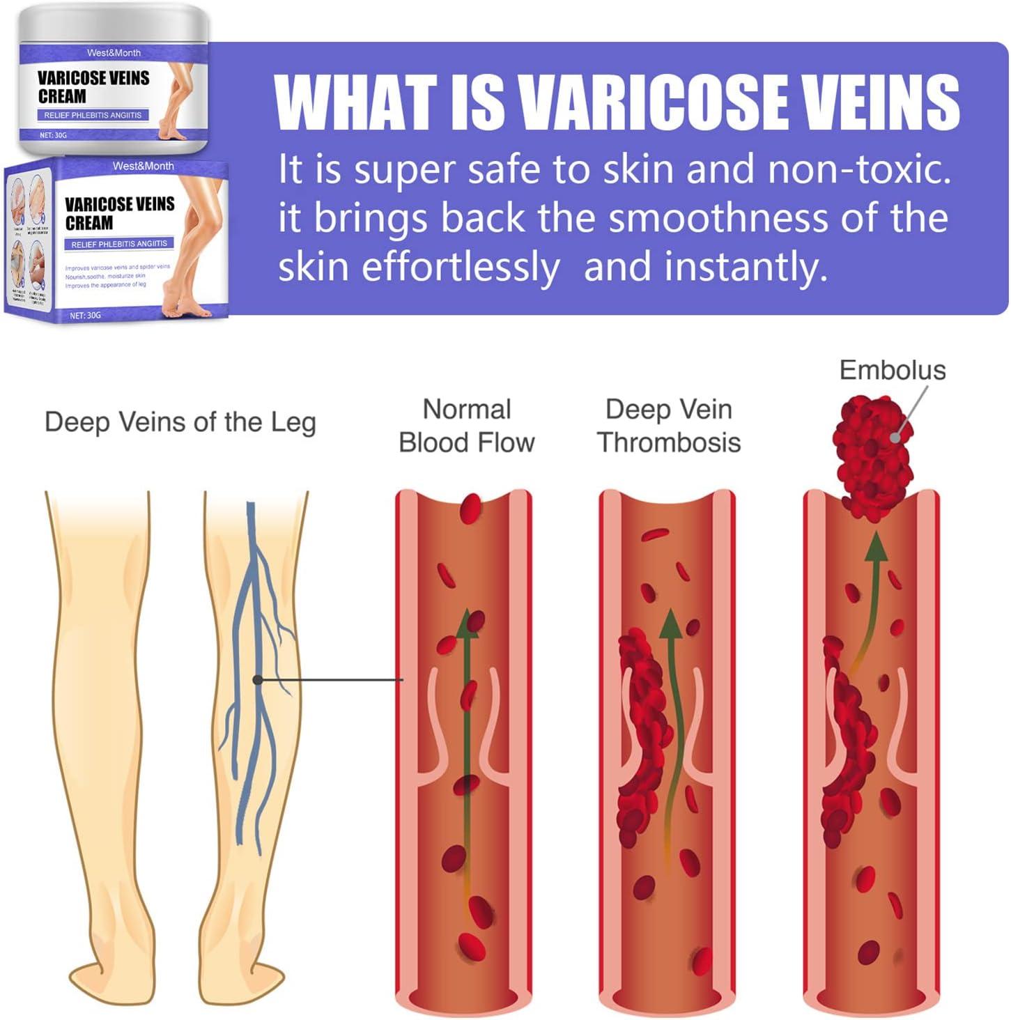 30g Varicose Vein Cream - Spider Vein Treatment & Phlebitis Skin Care ...