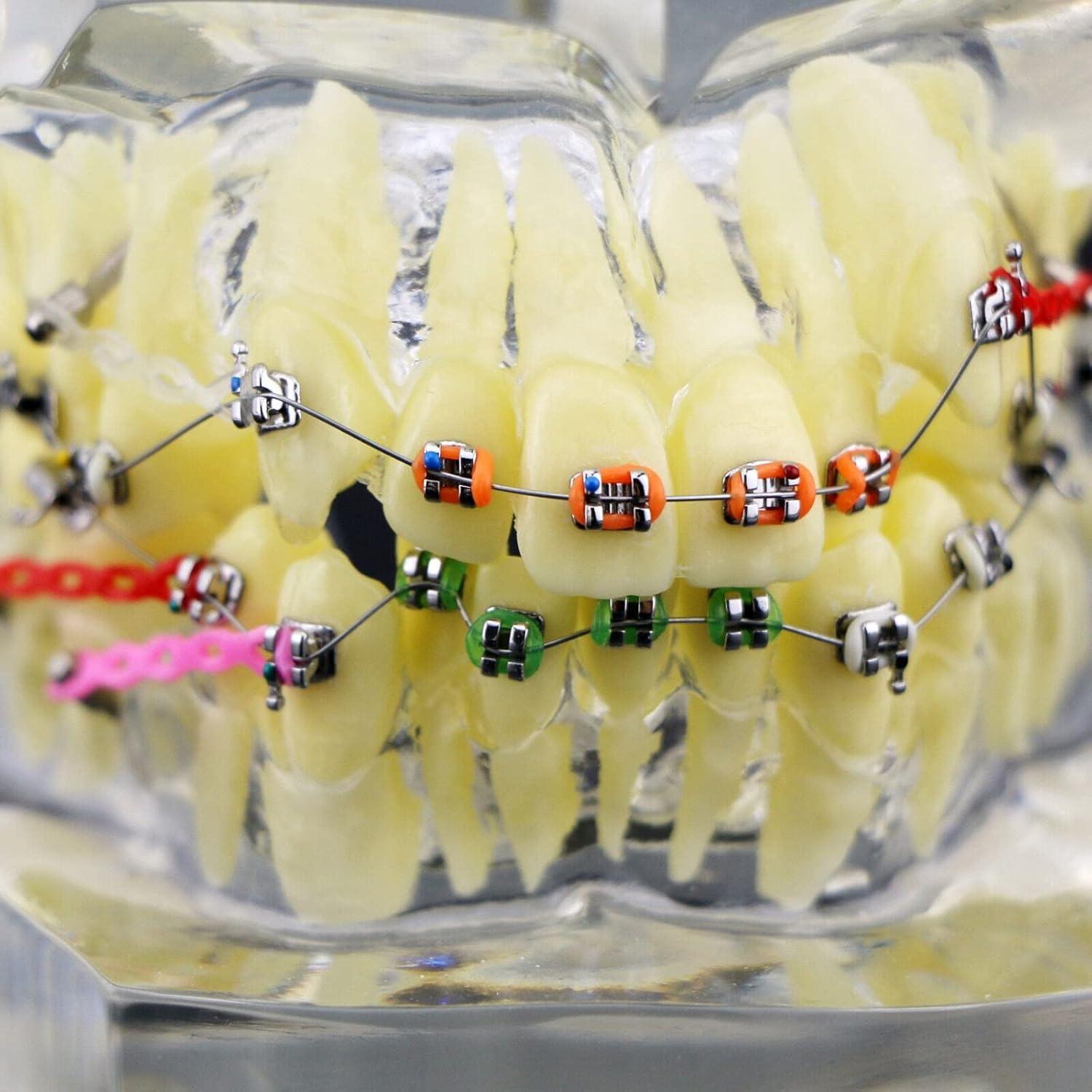 Orthodontic Tooth Model Orthodontic Dental Treatment Malocclusion Model ...