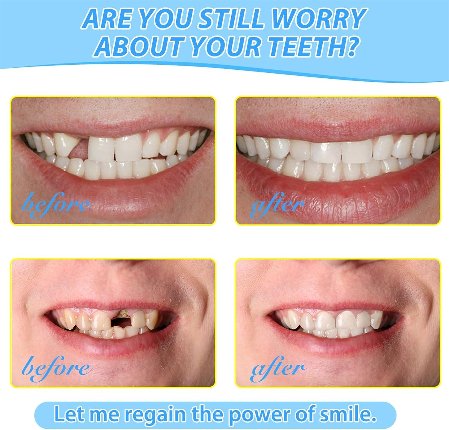 Temporary Tooth Filling Repair Kit with 4 Professional Tools and False ...