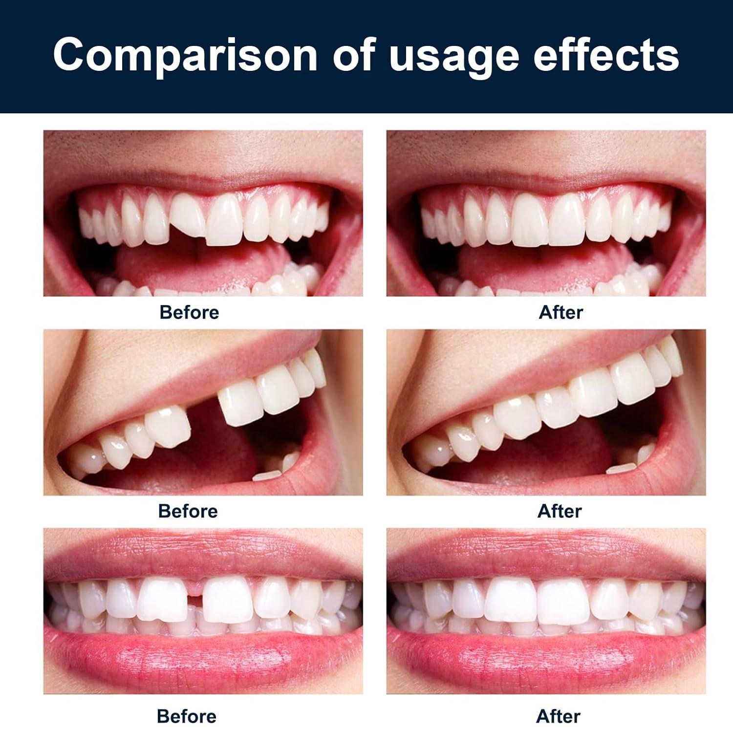 Temporary Tooth Repair Temporary Tooth Replacement Kit Temporary ...