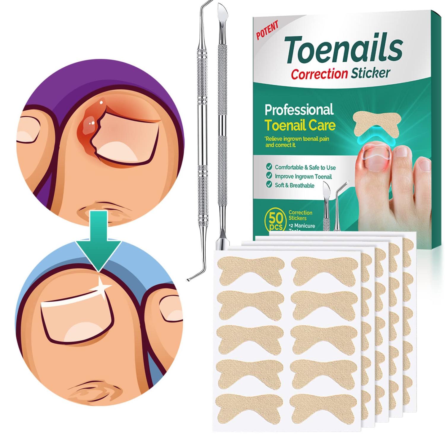 Ingrown Toenail Treatment Strips - Professional Solution for Paronychia ...