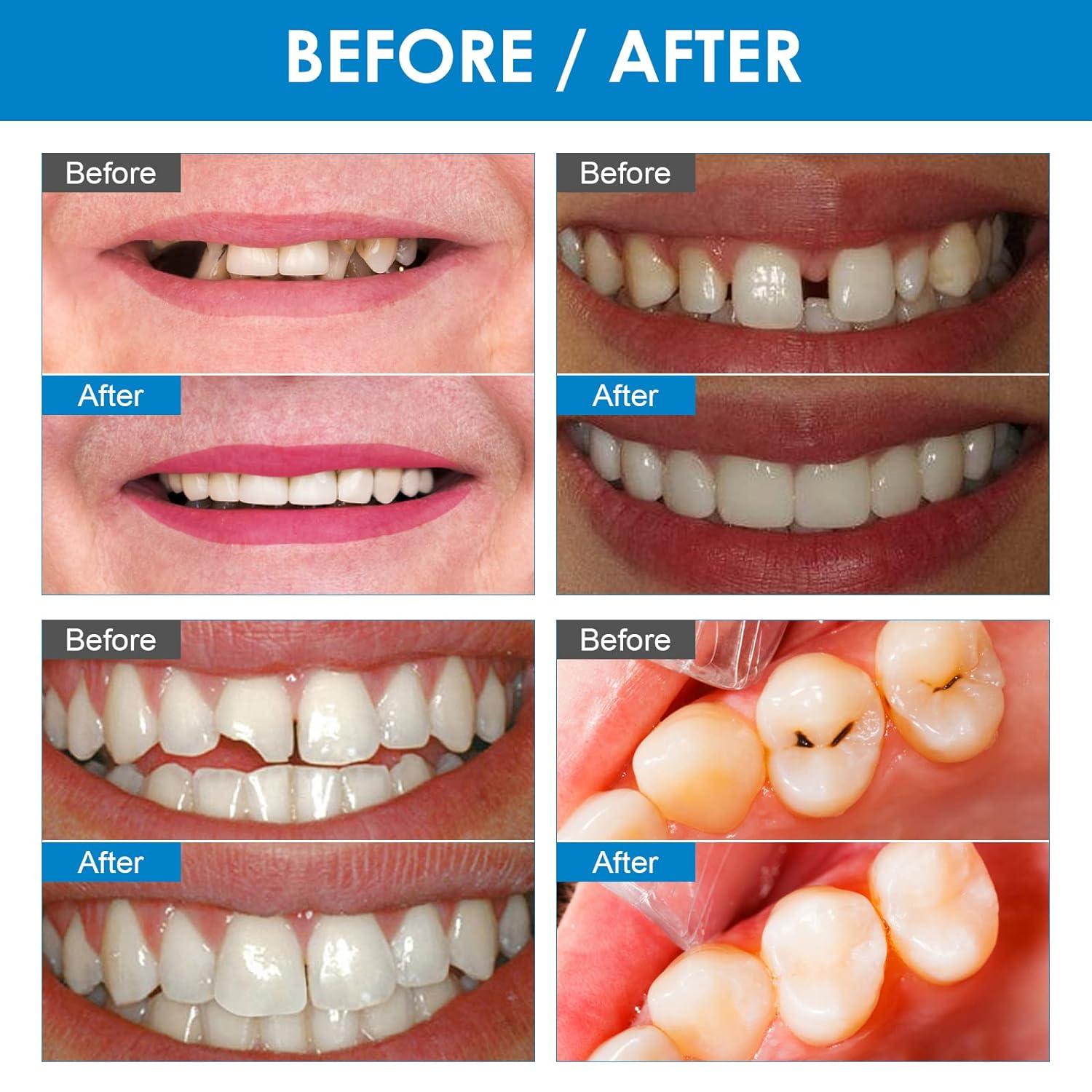 Moldable False Teeth Repair Kit - Dental Glue for Missing & Broken ...