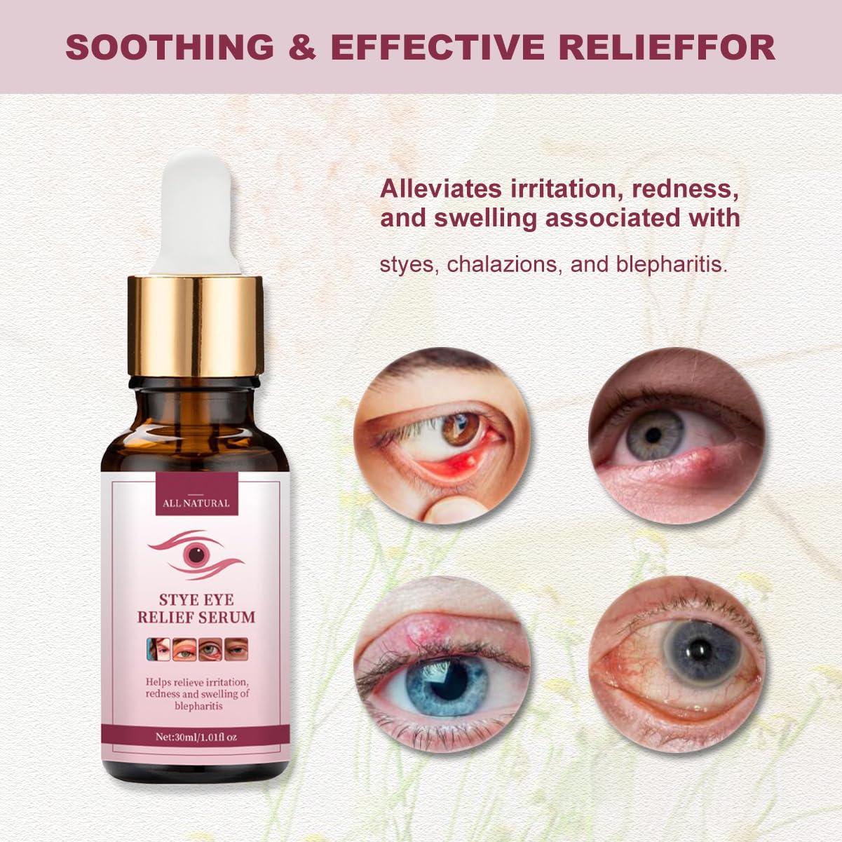 Stye Eye Treatment - Fast Relief for Styes Chalazion & Blepharitis ...