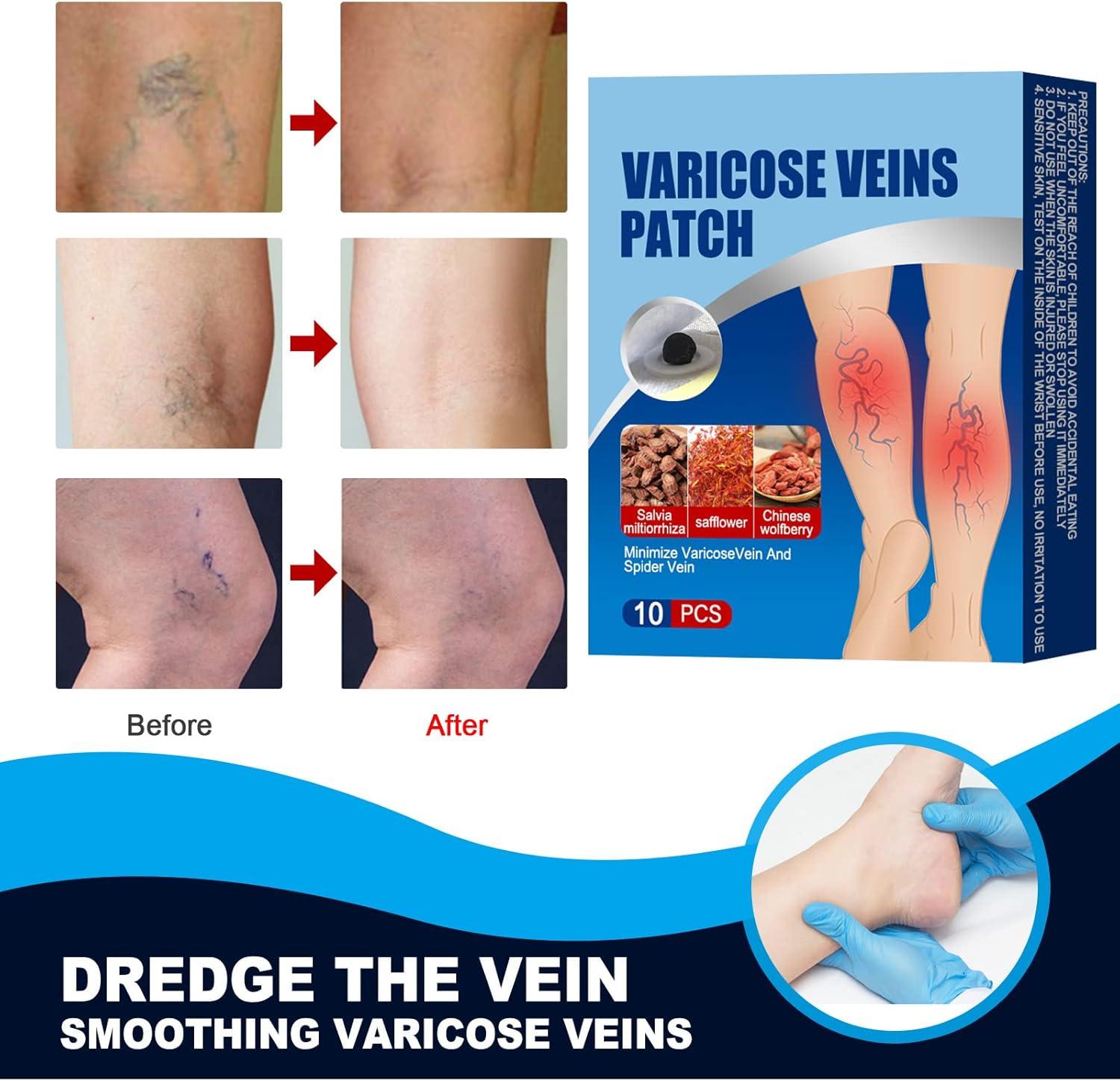 10PC Varicose Veins Patch | Effective Treatment for Varicose & Spider ...