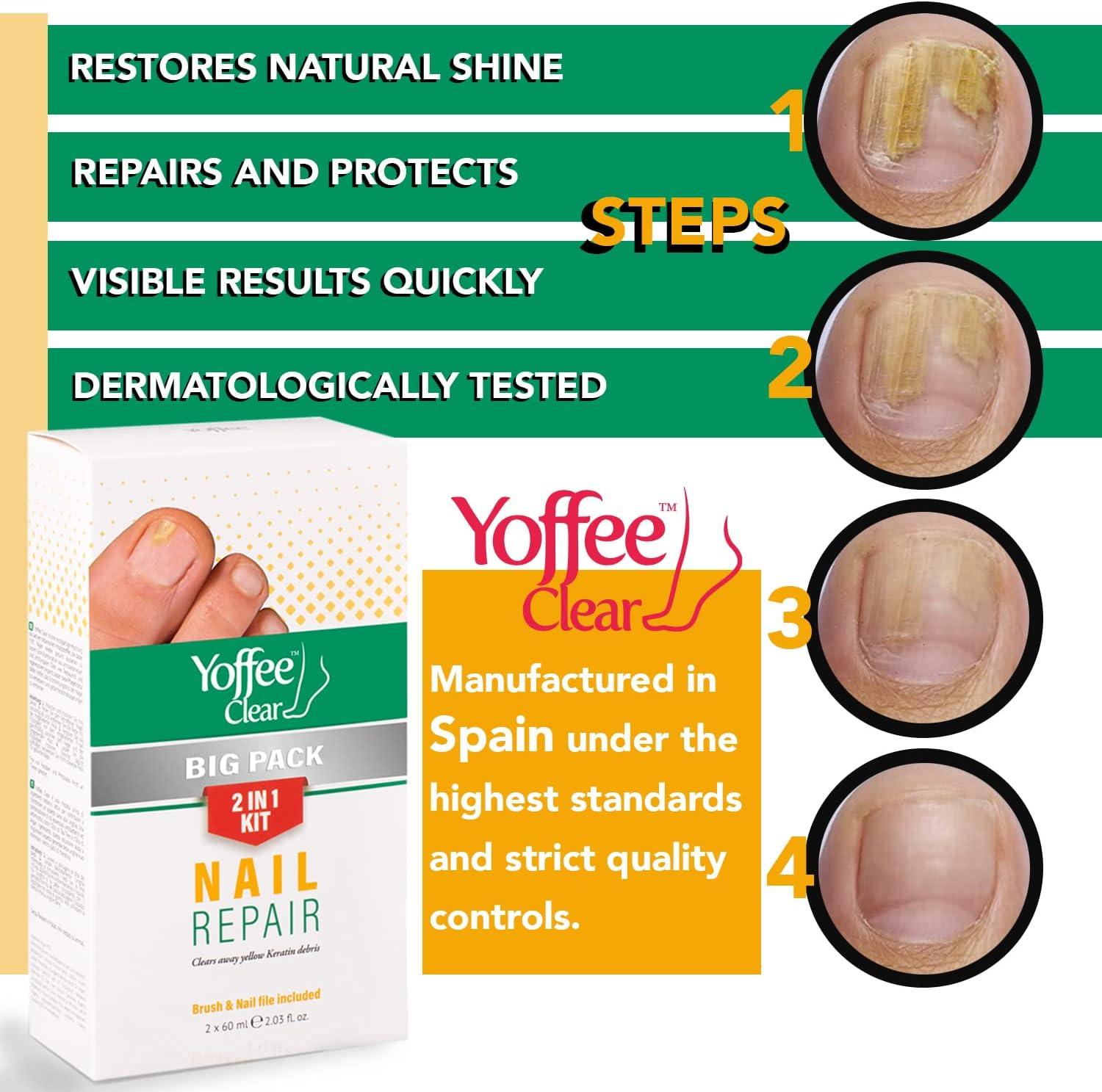 Yoffee Clear Nail Care Kit - 2 x 60ml Bottles, Fungal Nail Treatment ...