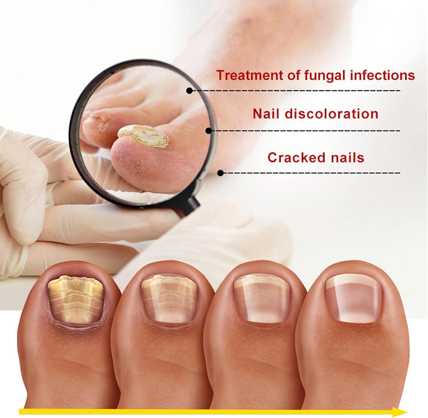 Anti Fungal Nail Treatment Nail Repair Kit with Nail Clippers & Glass ...