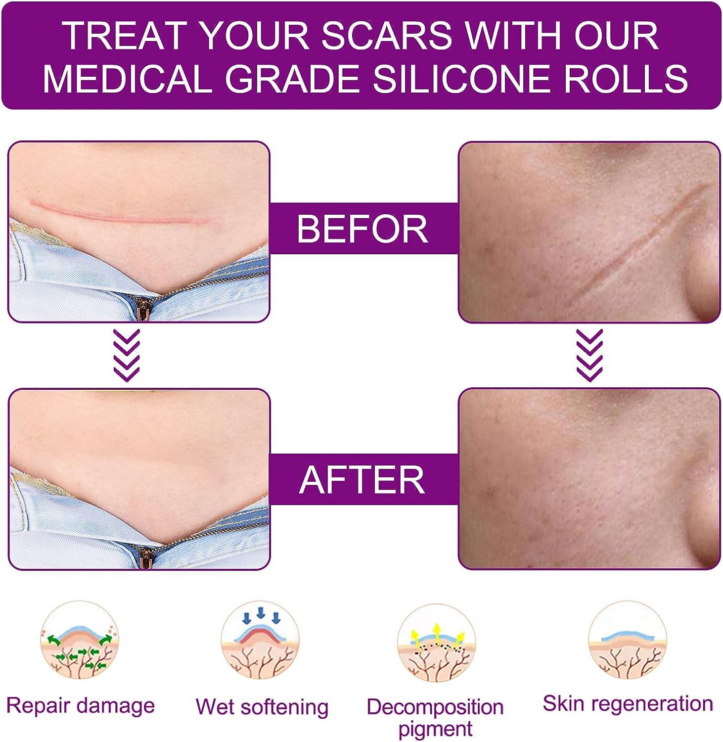 Silicone Scar Sheets 1.6x60 inches - Clear Silicone Scar Tape for Scar ...