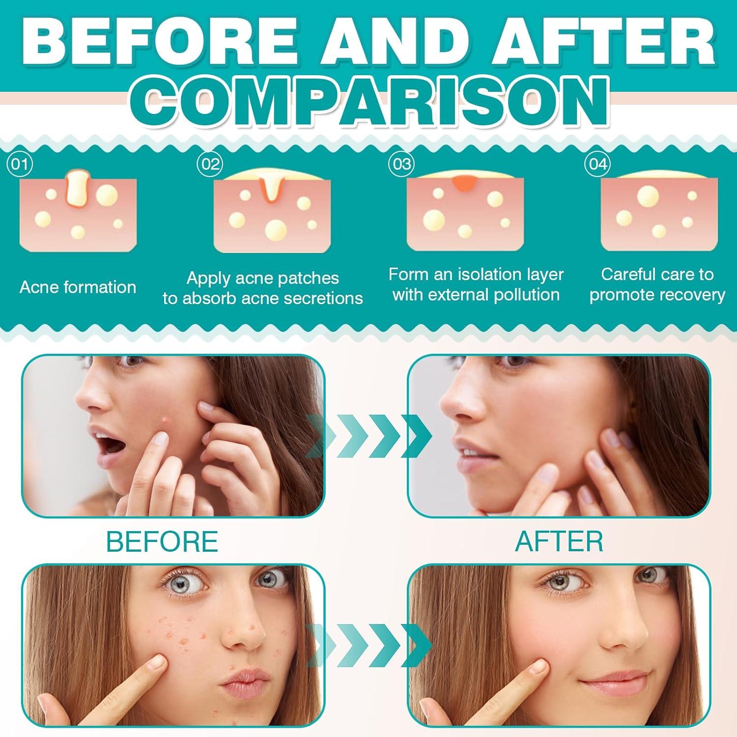 330 Pcs Hydrocolloid Pimple Patches - Korean Acne Treatment ...