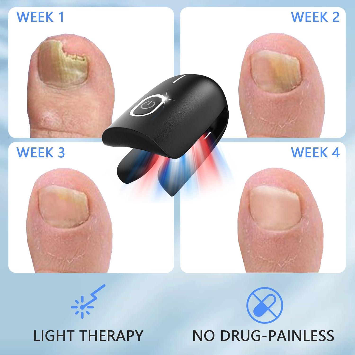 Nail Fungus Laser Treatment Device for Home Use | Effective ...
