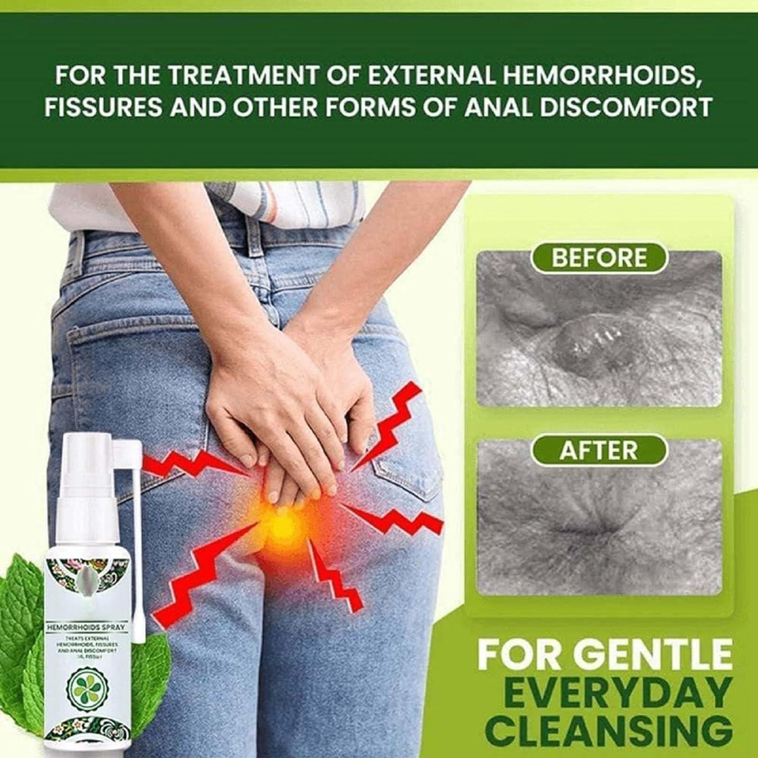 Hemorrhoids Relief Spray 30ml | Natural Treatment for Piles & Anal ...