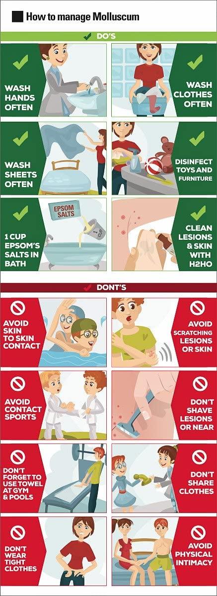 Conzerol 2 Step Treatment: Stop Molluscum Contagiosum Naturally, Pain ...