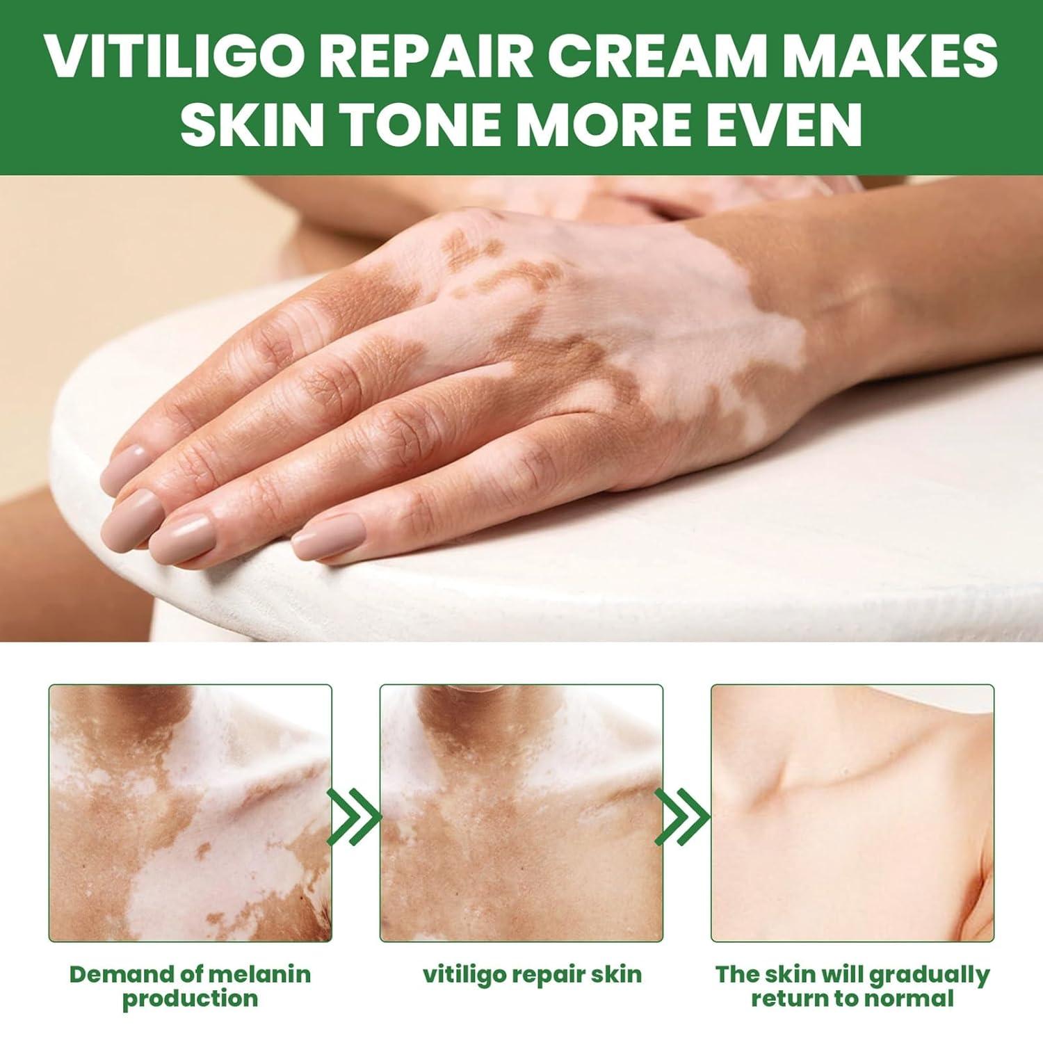 Vitiligo Fix Revitalize Elixir - 2023 New Psoriasis Relief ...