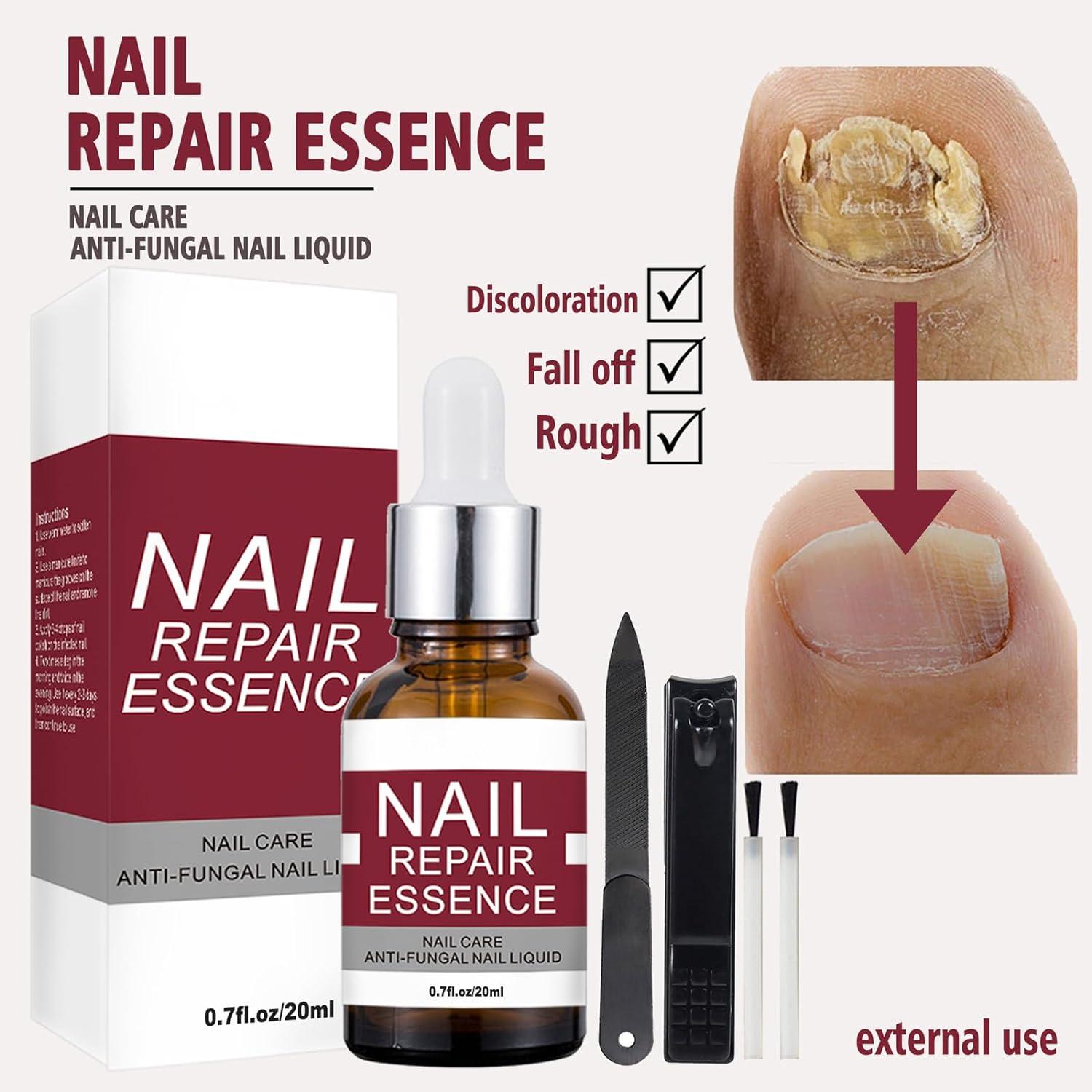 Extra Strong Fungal Nail Treatment - Nail Fungus Remover Kit with File ...