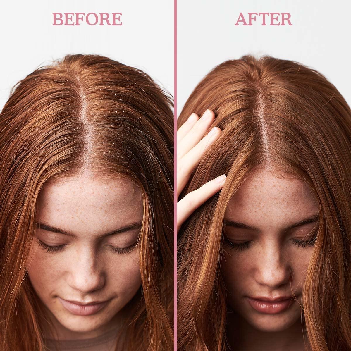 Umberto Giannini Scalp Restore Conditioner | Vegan Anti-Dandruff ...