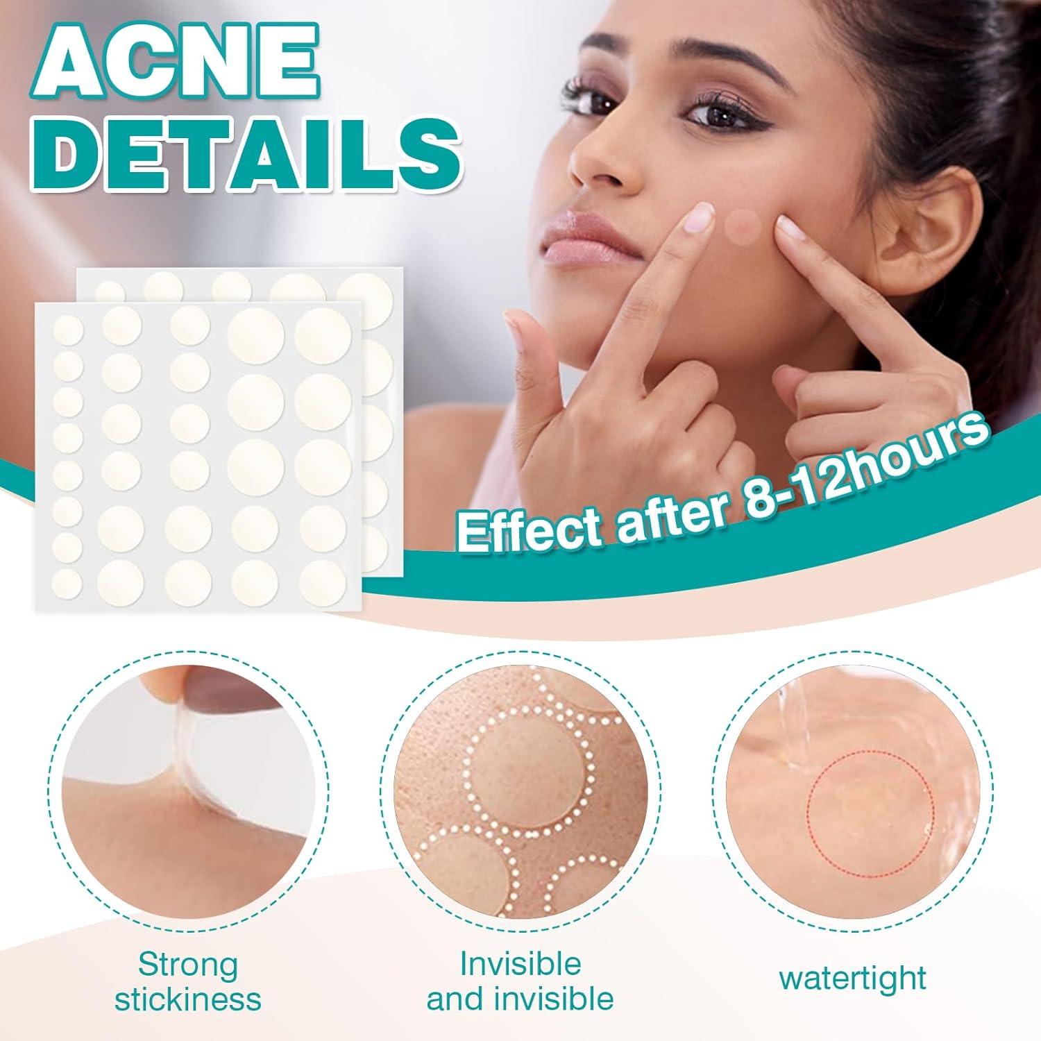 330 Pcs Hydrocolloid Pimple Patches - Korean Acne Treatment ...