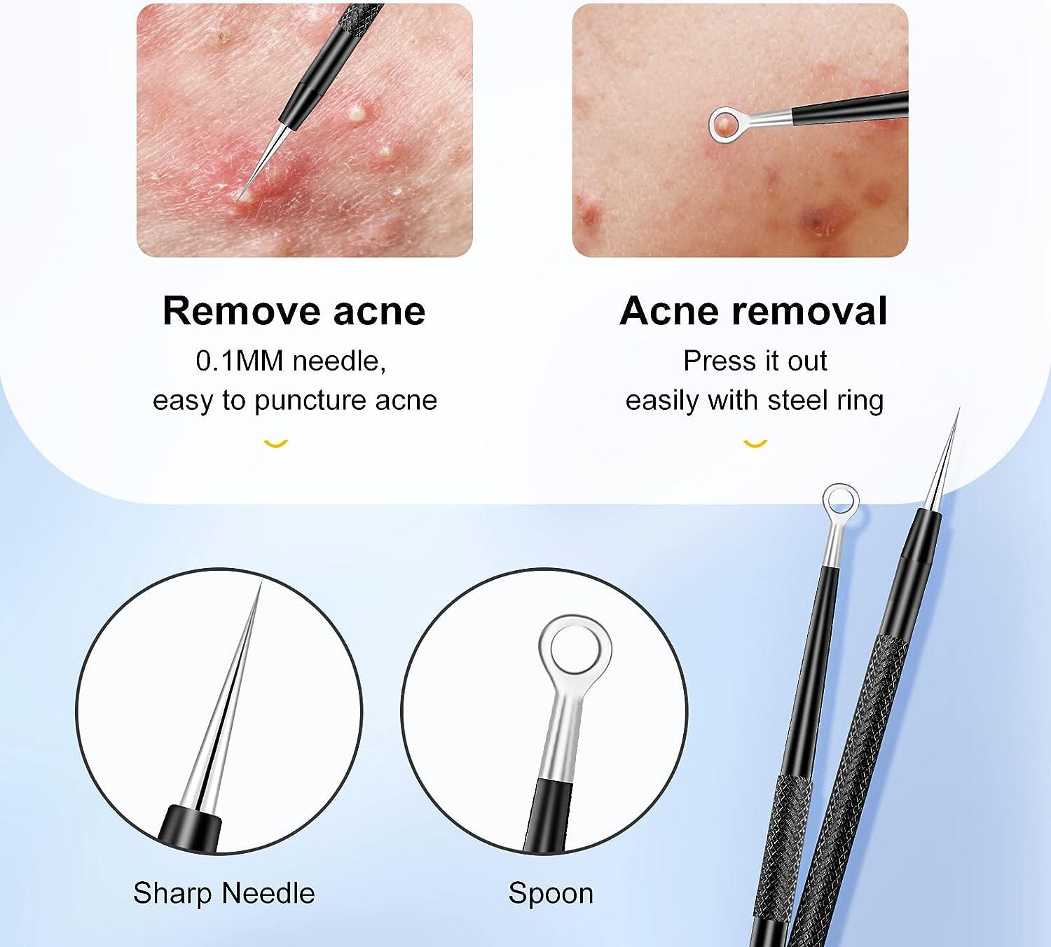 Blackhead & Pimple Extractor Tool Kit for Face - Blemish & Whitehead ...