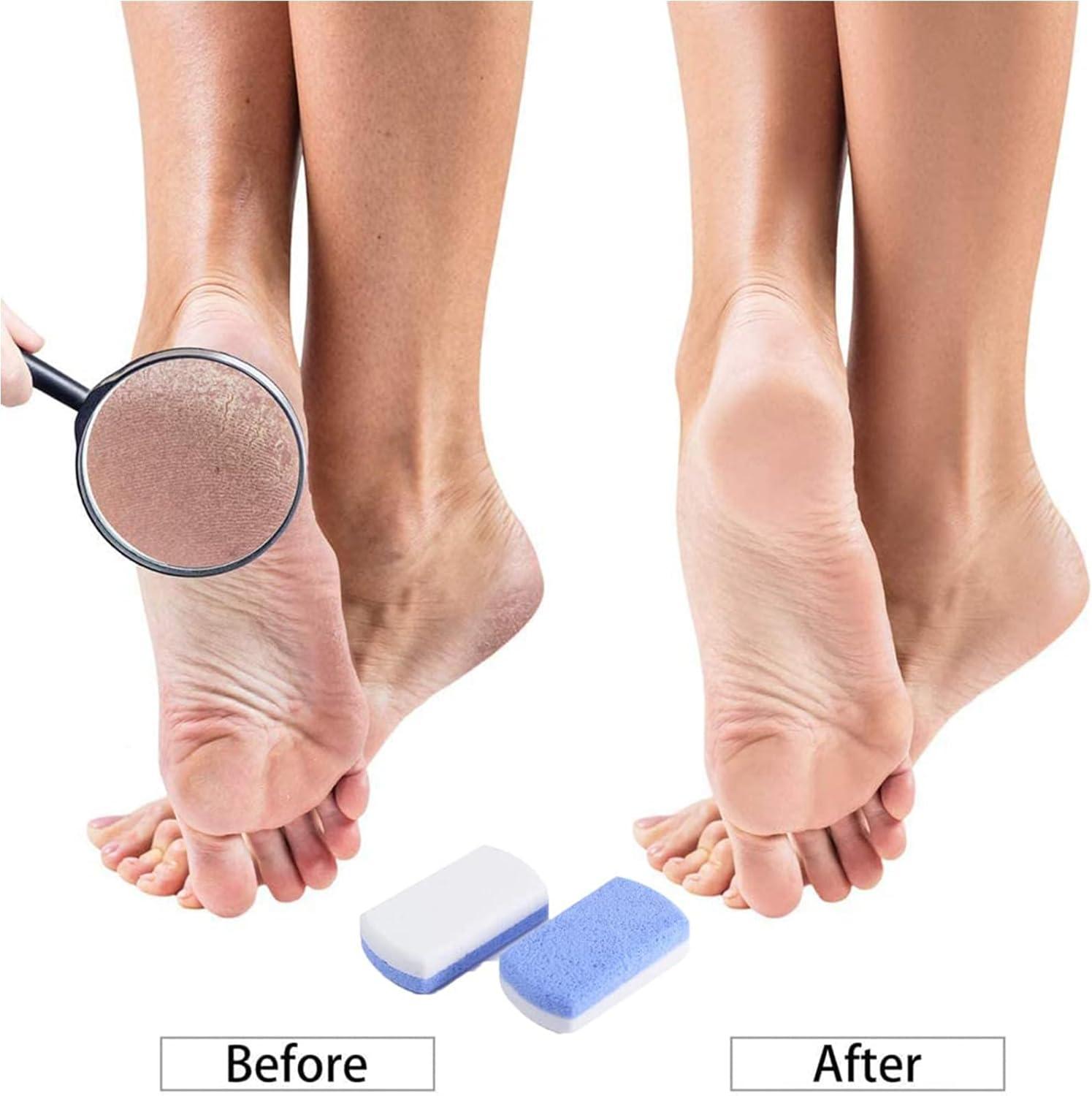 Pumice Stone Set for Feet | Callus Remover Scrubber Pedicure Exfoliator ...