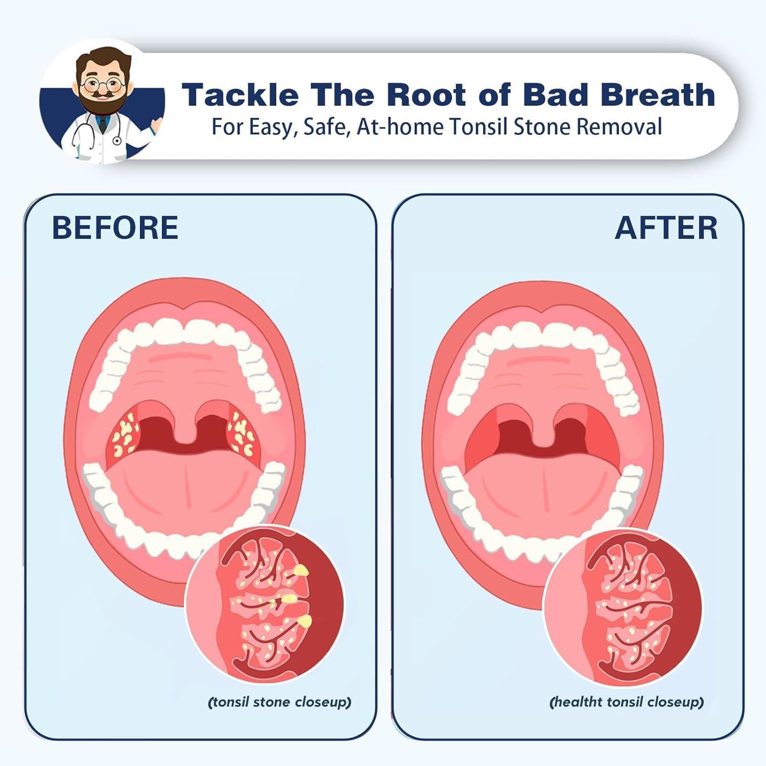 Tonsil Stone Remover | Clean & Fight Bad Breath | Oral Irrigator Tool ...