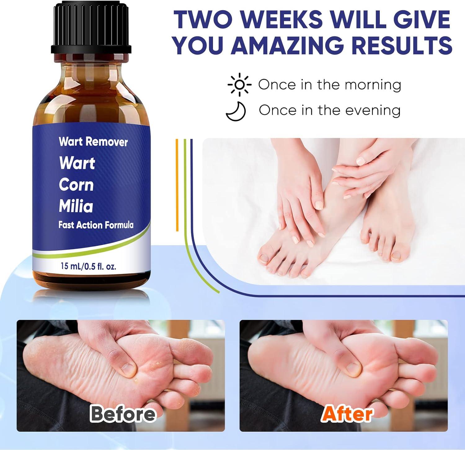 NNR Liquid Wart Remover - Fast Acting Plantar Wart Treatment for Feet ...