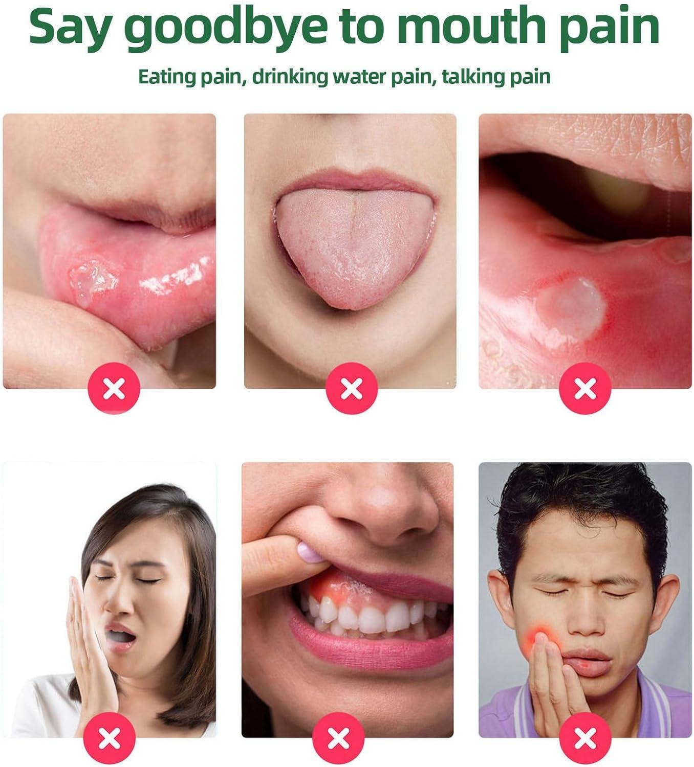 Ulcer Breath Sprays Mouth Ulcers Treatment Spray Ulcer Treatment Canker ...