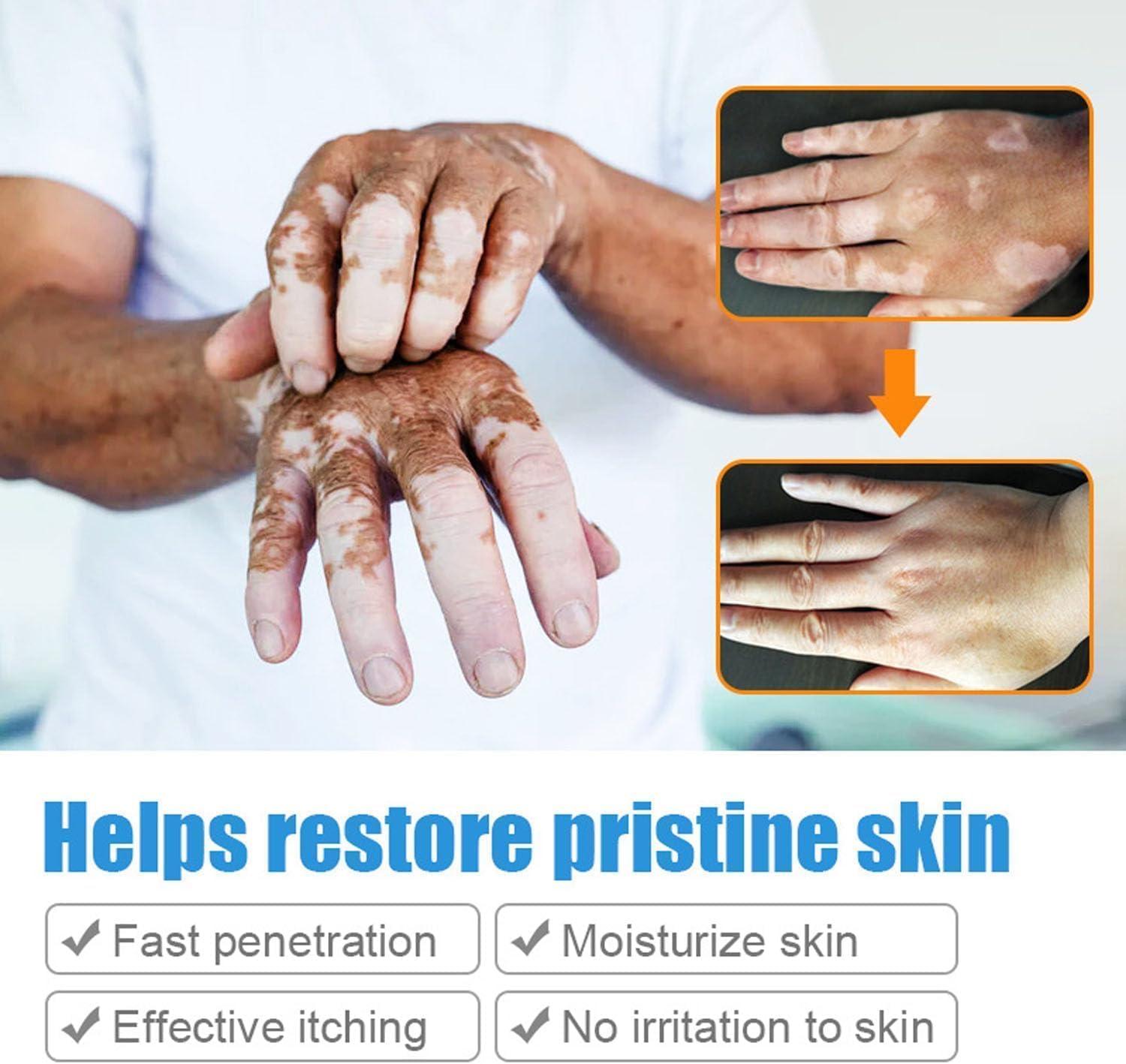 EXQST Vitiligo Care Cream - Targeted Treatment for Even Skin Tone | Buy ...
