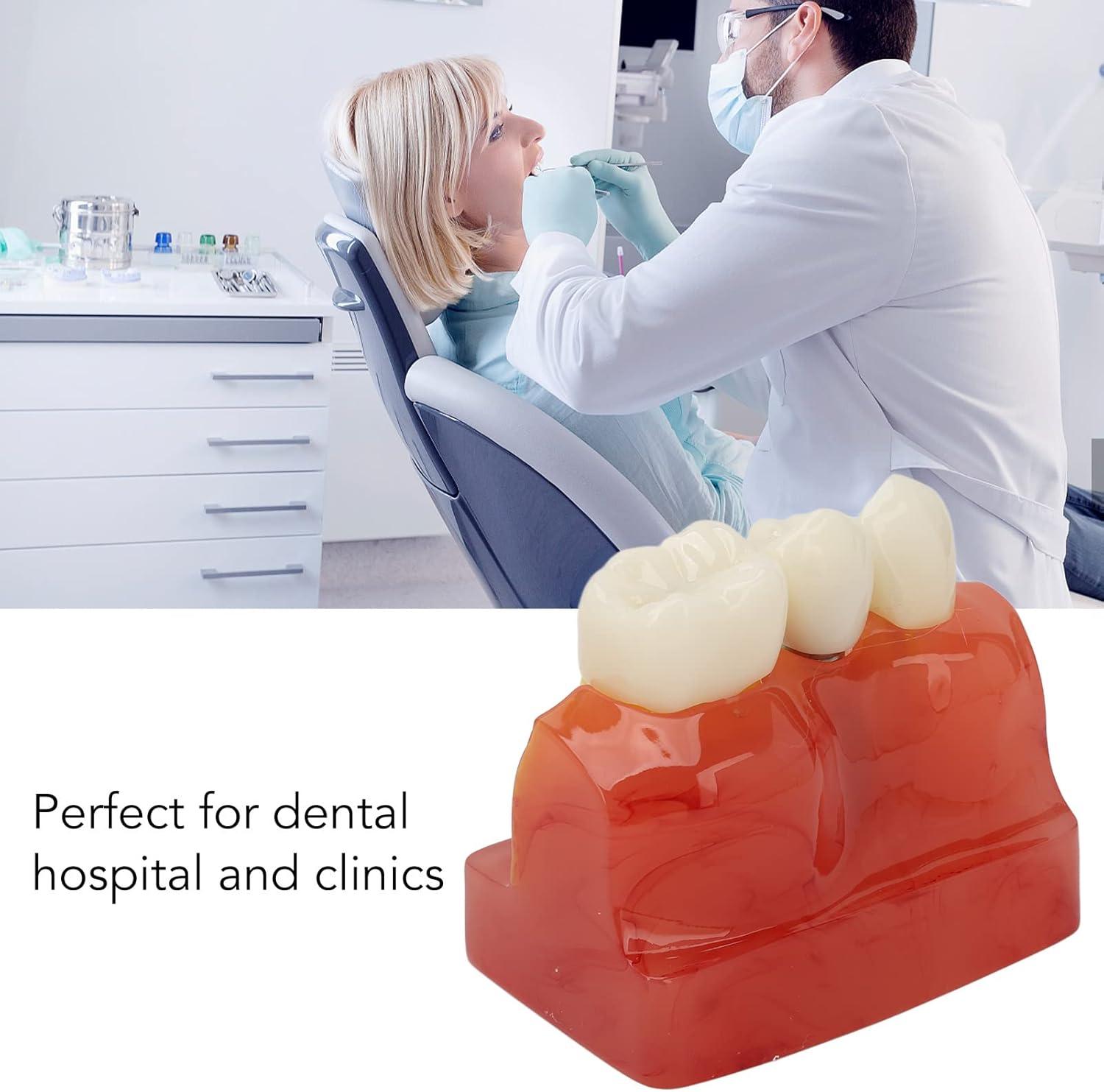 Verdant Touch Crown Bridge Demonstration Model - 4X Dental Implant ...