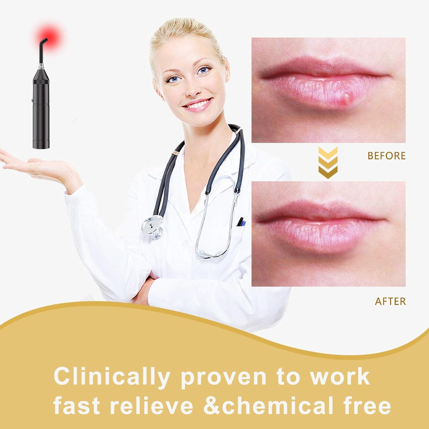 2023 Newest Red Light Therapy Device for Cold Sore & Canker Sore ...