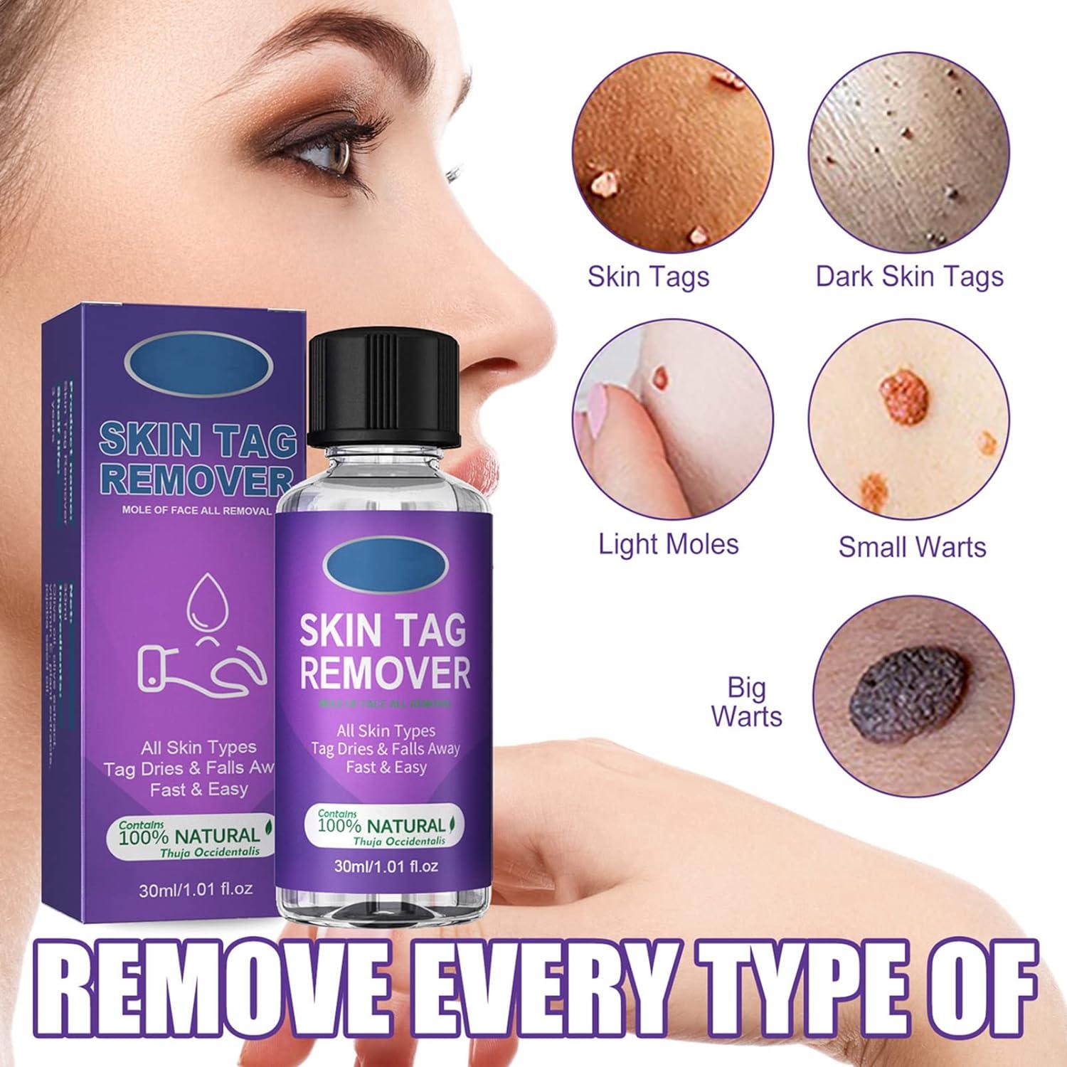 Skin Tag & Mole Removal Set - Natural Wart Remover & Corrector (3PCS ...