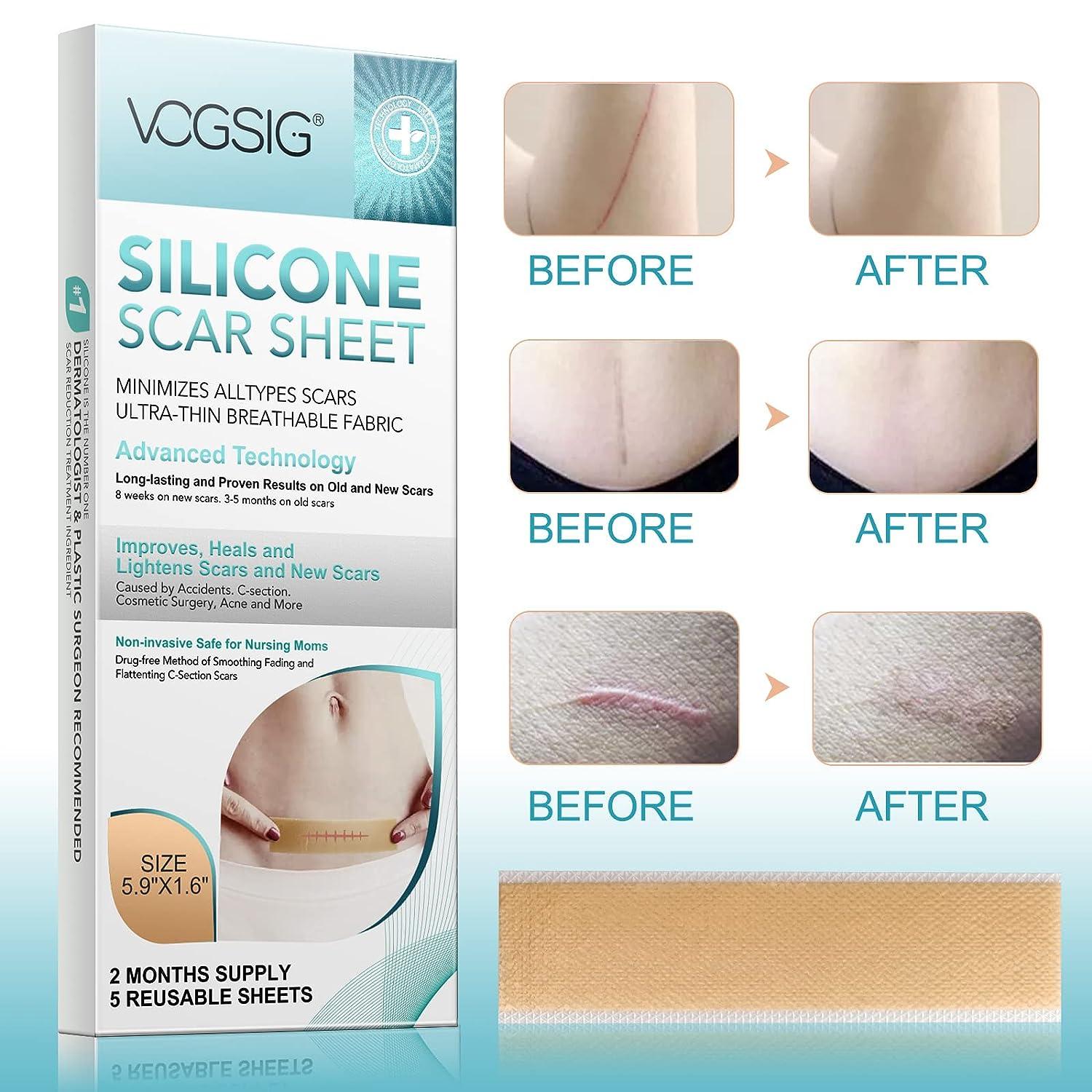 Medical Grade Silicone Scar Strips - 5 Reusable Sheets for Surgical ...