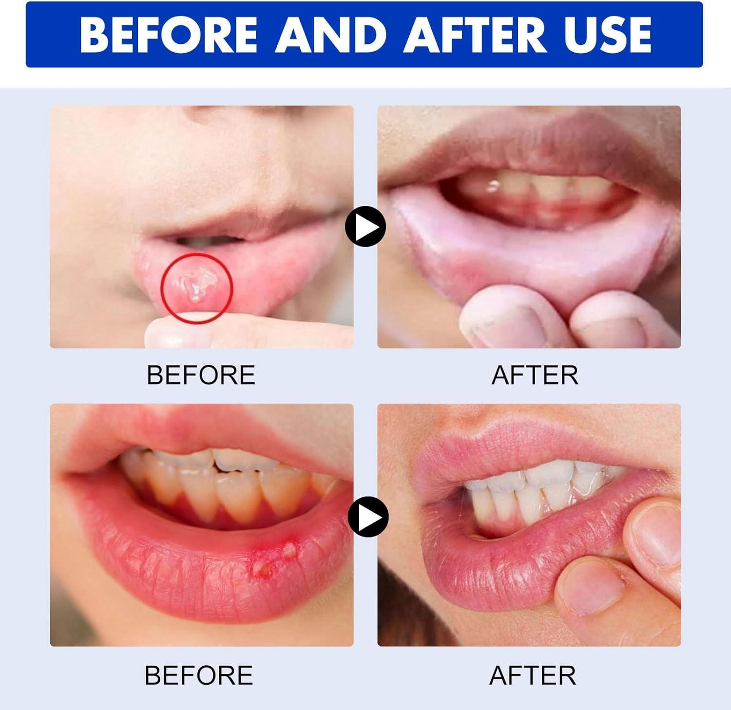 Mouth Ulcer Spray Ulcer Breath Sprays Mouth Ulcer Treatment Spray Ulcer ...