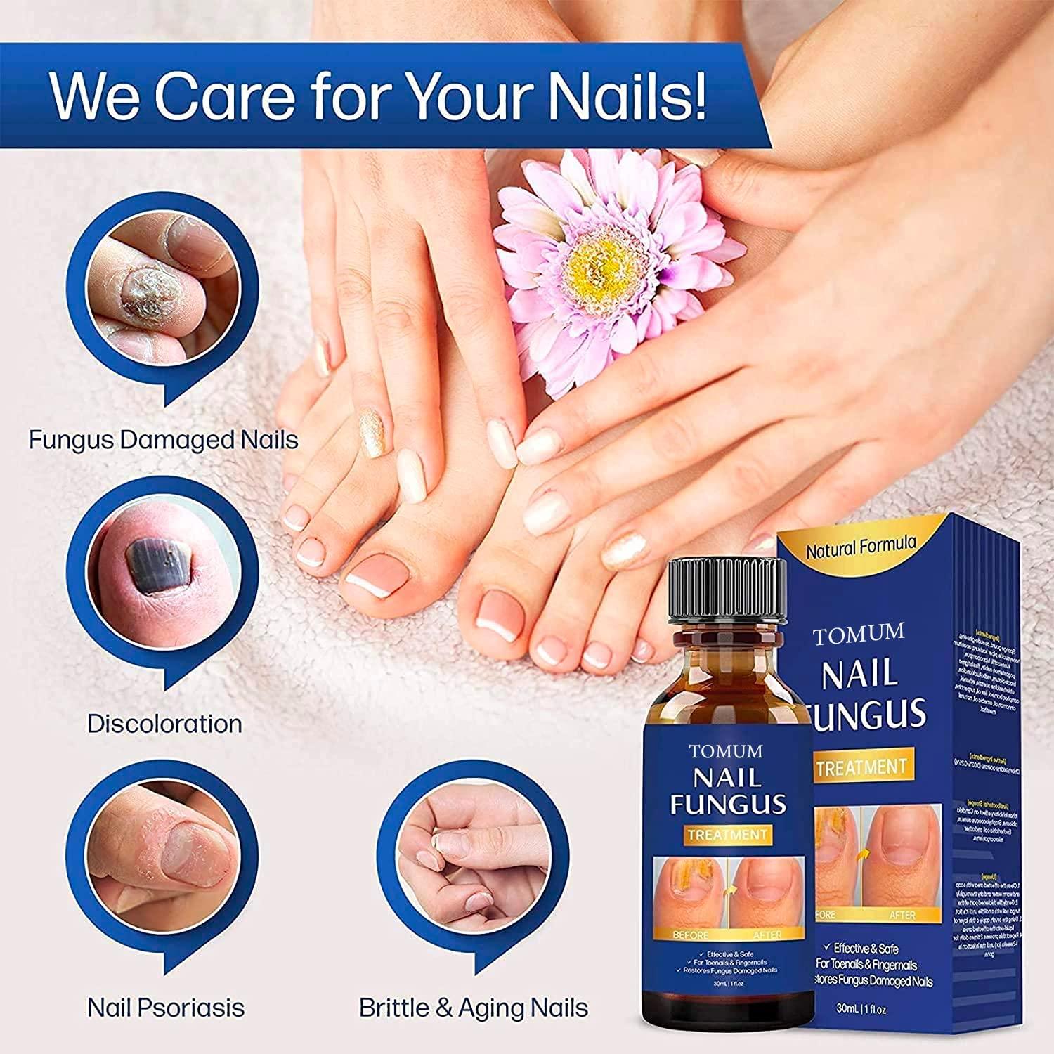 Extra Strength Toe Nail Fungus Treatment for Healthy Nails - Nail ...