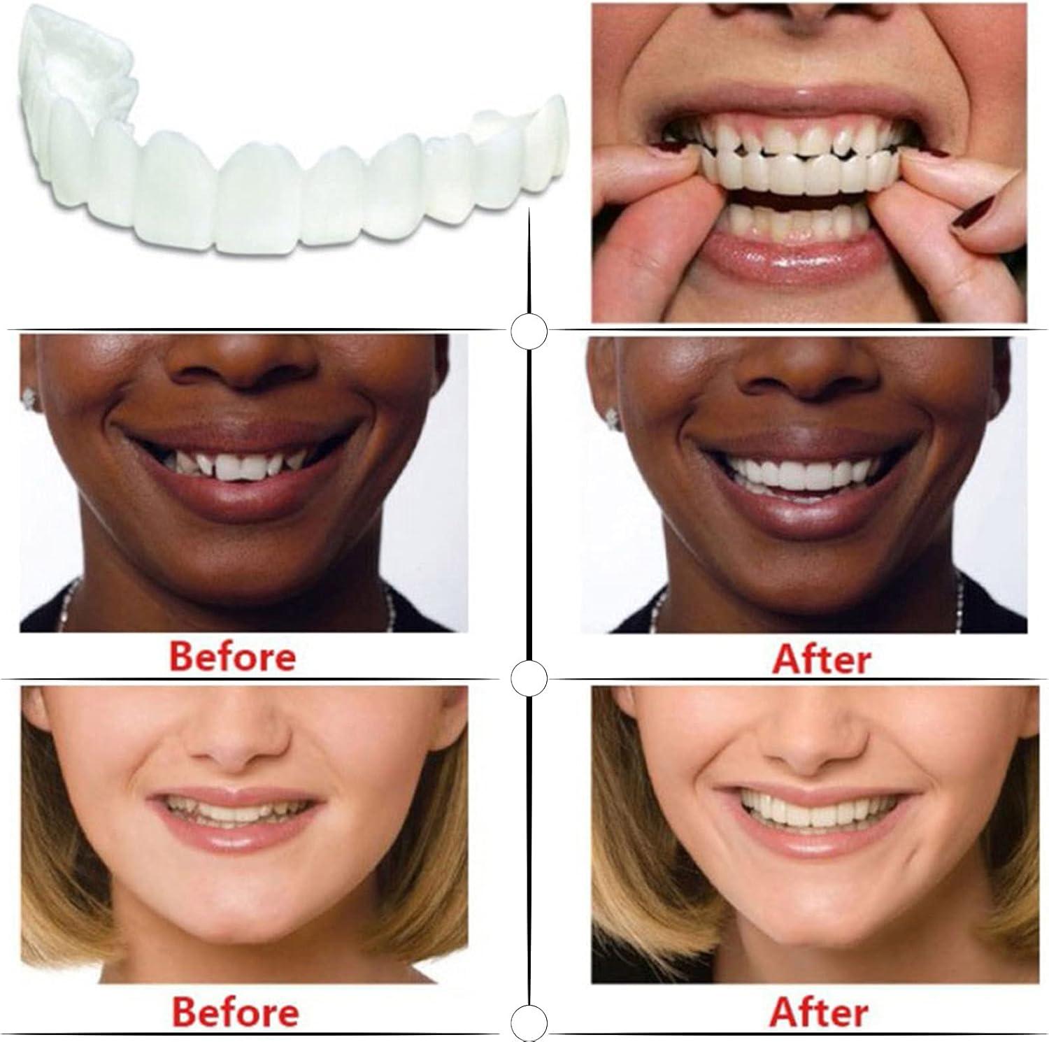 Rompa Veneers - 2 Pairs of Plug-In Fake Teeth for Men & Women | Cover ...