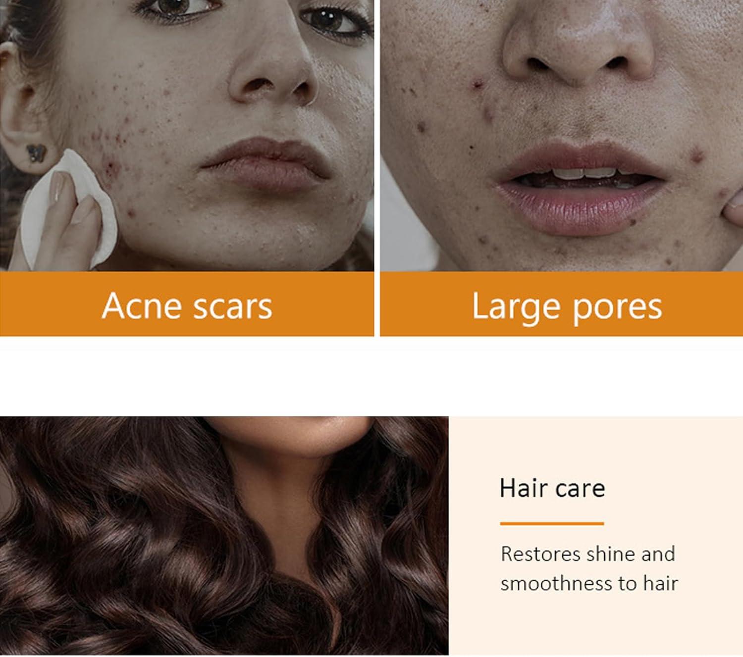 coconut oil for acne scars