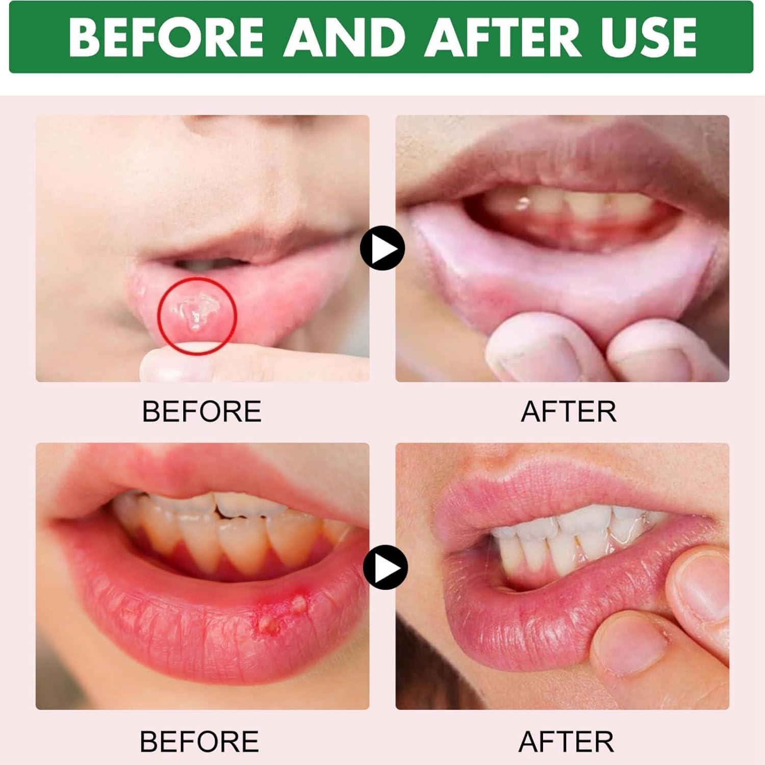 Mouth Ulcer Spray Mouth Ulcer Treatment Spray for Adluts Ulcer Breath ...