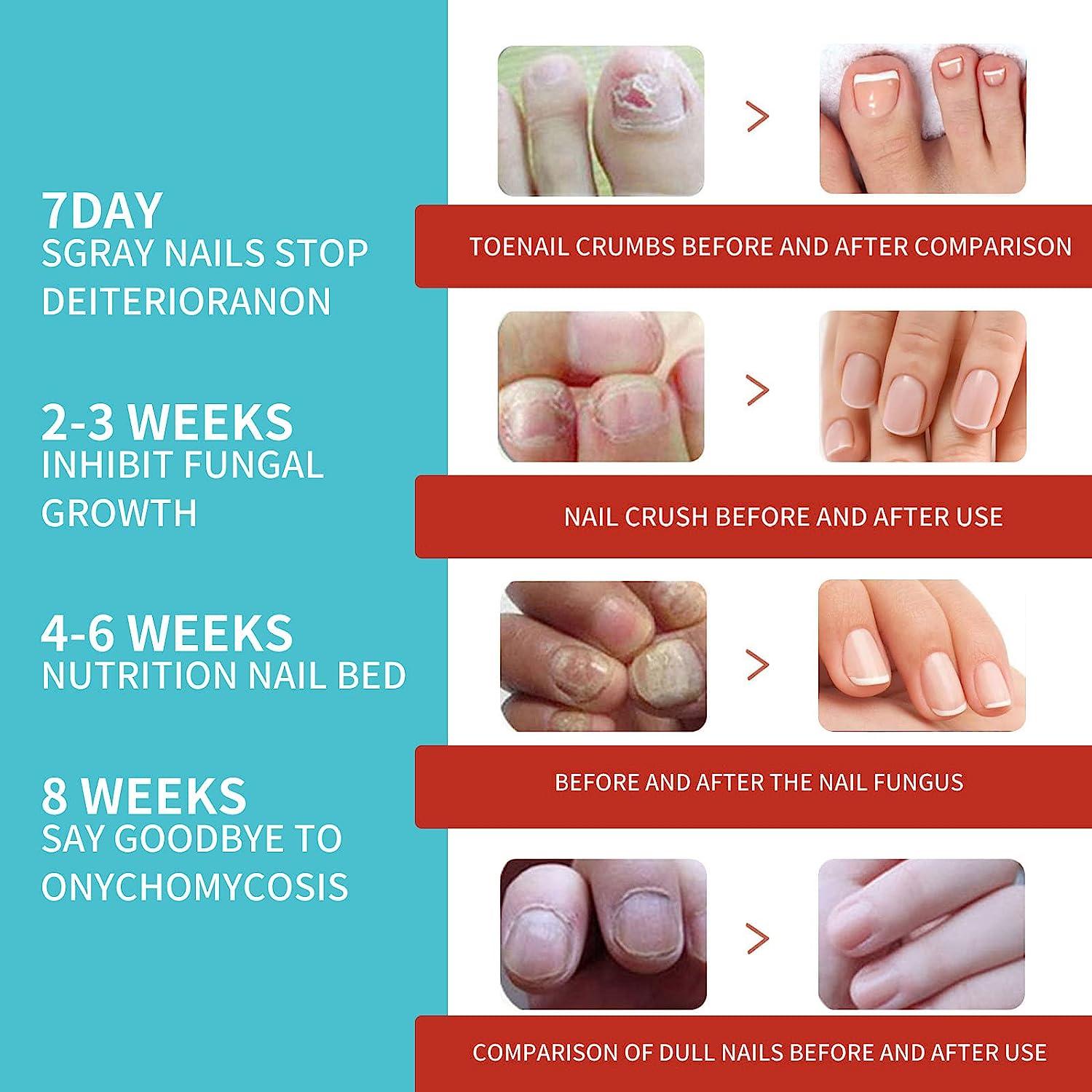 Fungal Nail Renewal Patches - 16 Nighttime Toe Nail Patches for Safe ...