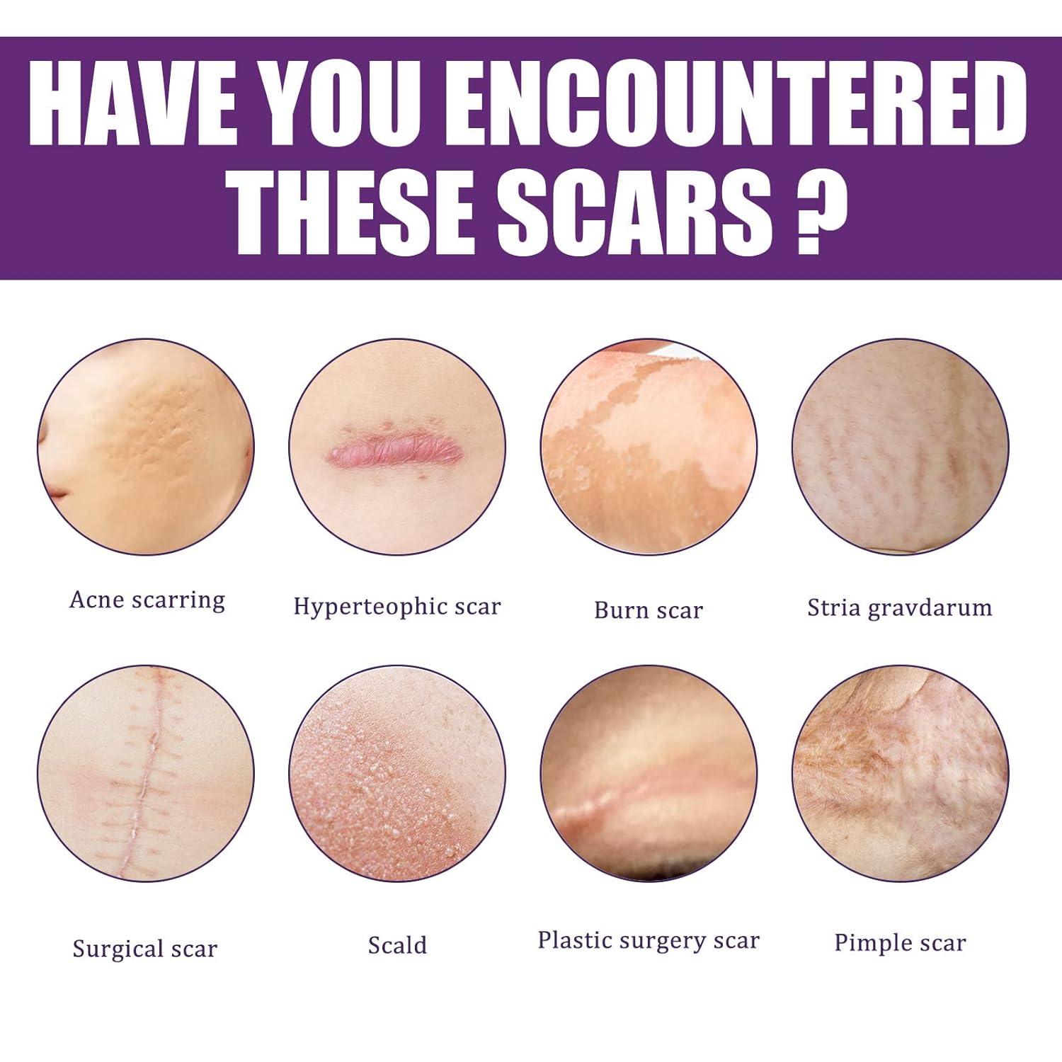 Silicone Scar Removal Sheets - Professionals Choice for Surgery, Burns ...